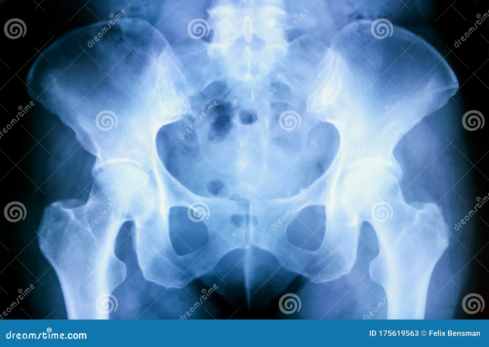 X-ray of Pelvic Bones Anatomy Stock Image - Image of diagnosis ...