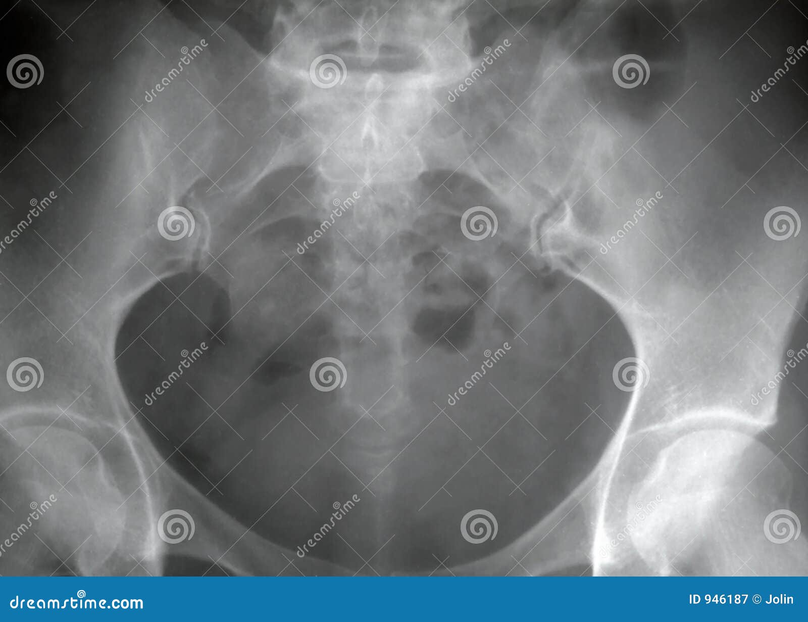 X-ray Of The Pelvis Picture. Image: 946187