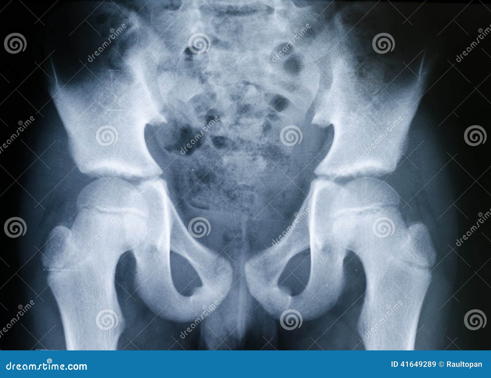 X-Ray of the Pelvis and Hip Joint Stock Image - Image of disease, femur ...