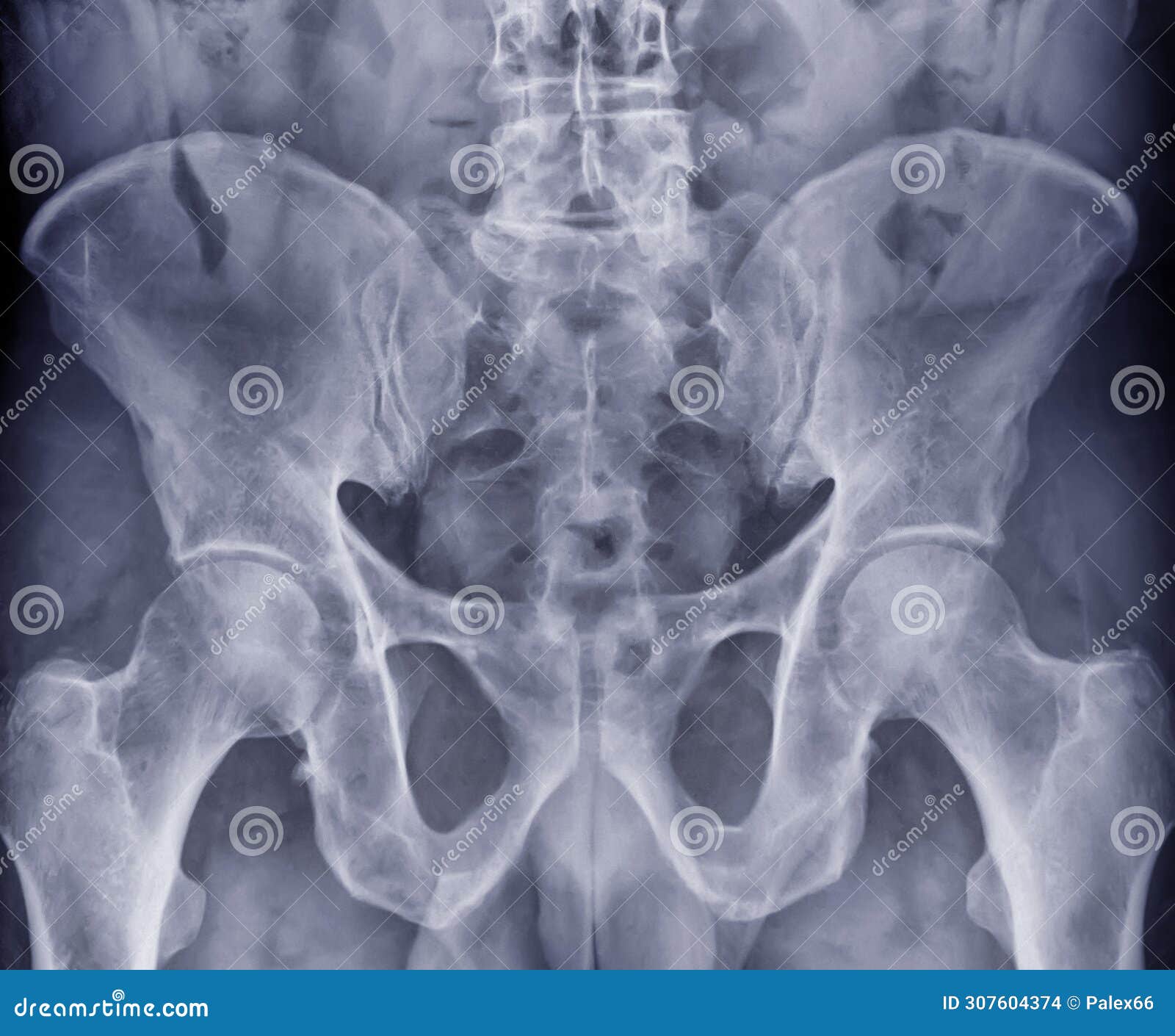 X-ray of the Pelvis of a Man Stock Photo - Image of nurse, care: 307604374