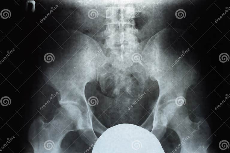 X-ray of the Pelvis and Sacrum. X-ray Stock Photo - Image of body ...