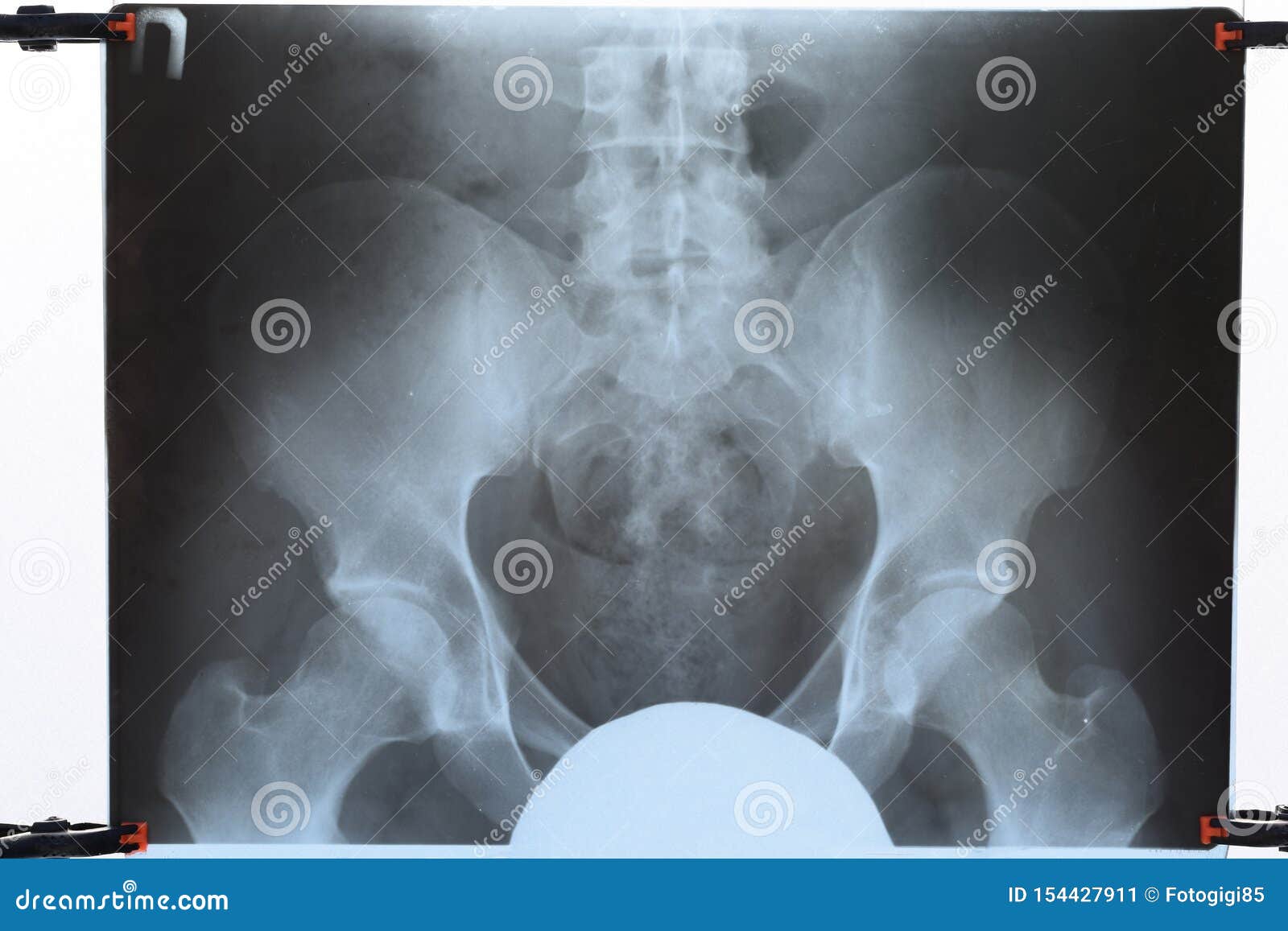 X-ray of the Pelvis and Sacrum. X-ray Stock Image - Image of pelvis ...