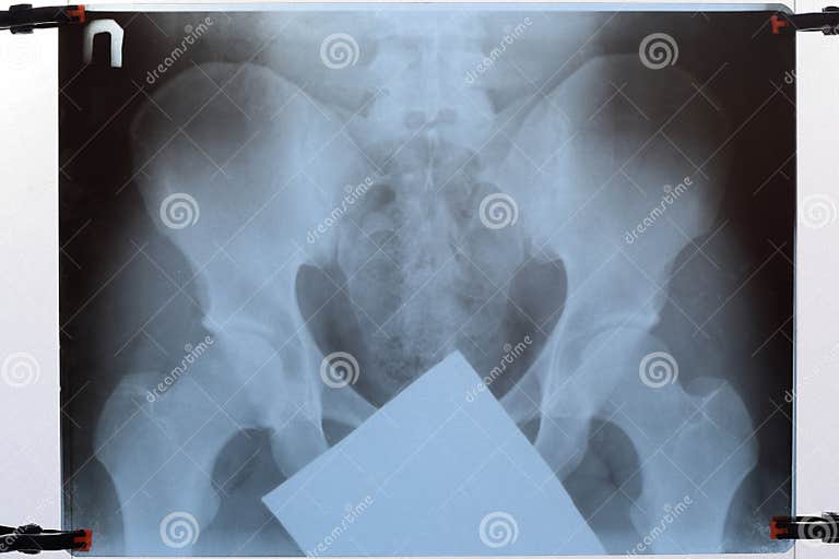 X-ray of the Pelvis and Sacrum. X-ray Stock Image - Image of arthritis ...