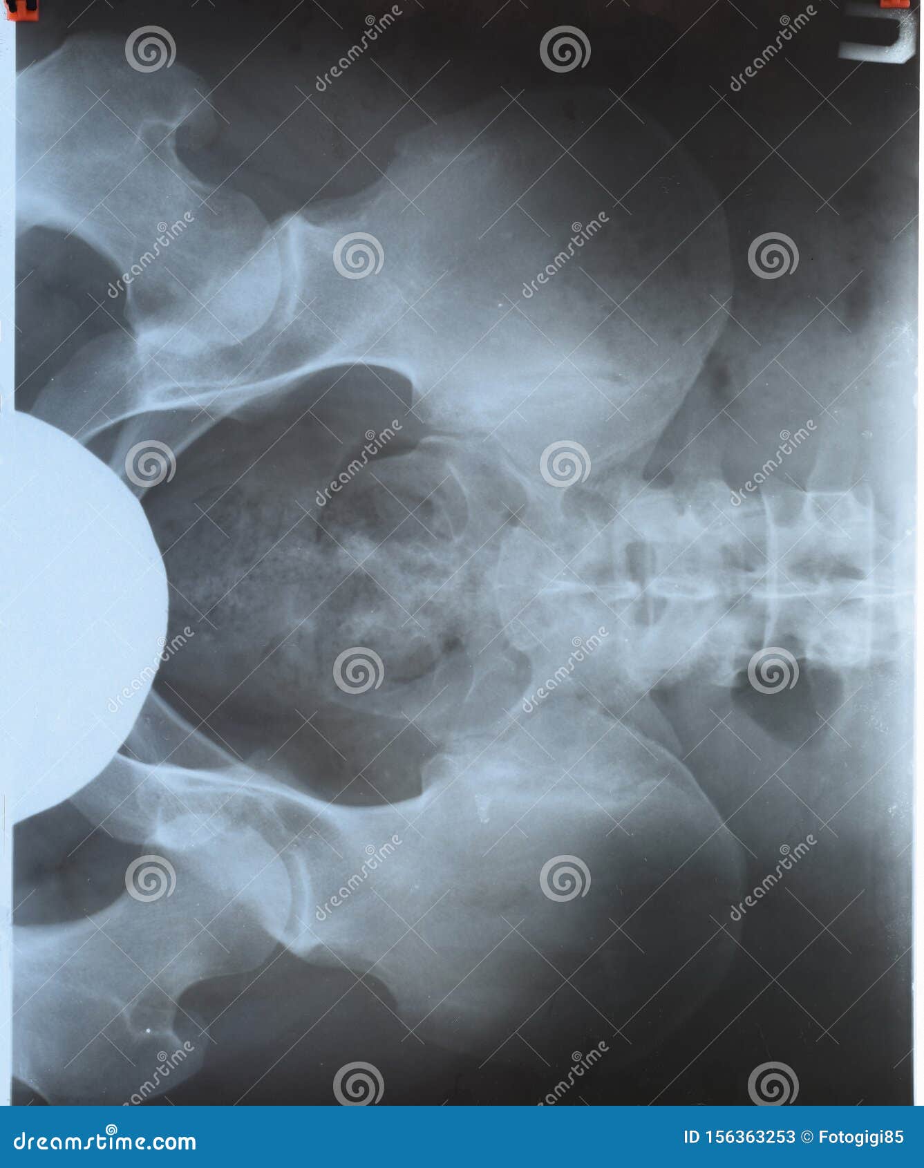 X-ray of the and Sacrum. X-ray Stock Image - Image of arthritis ...