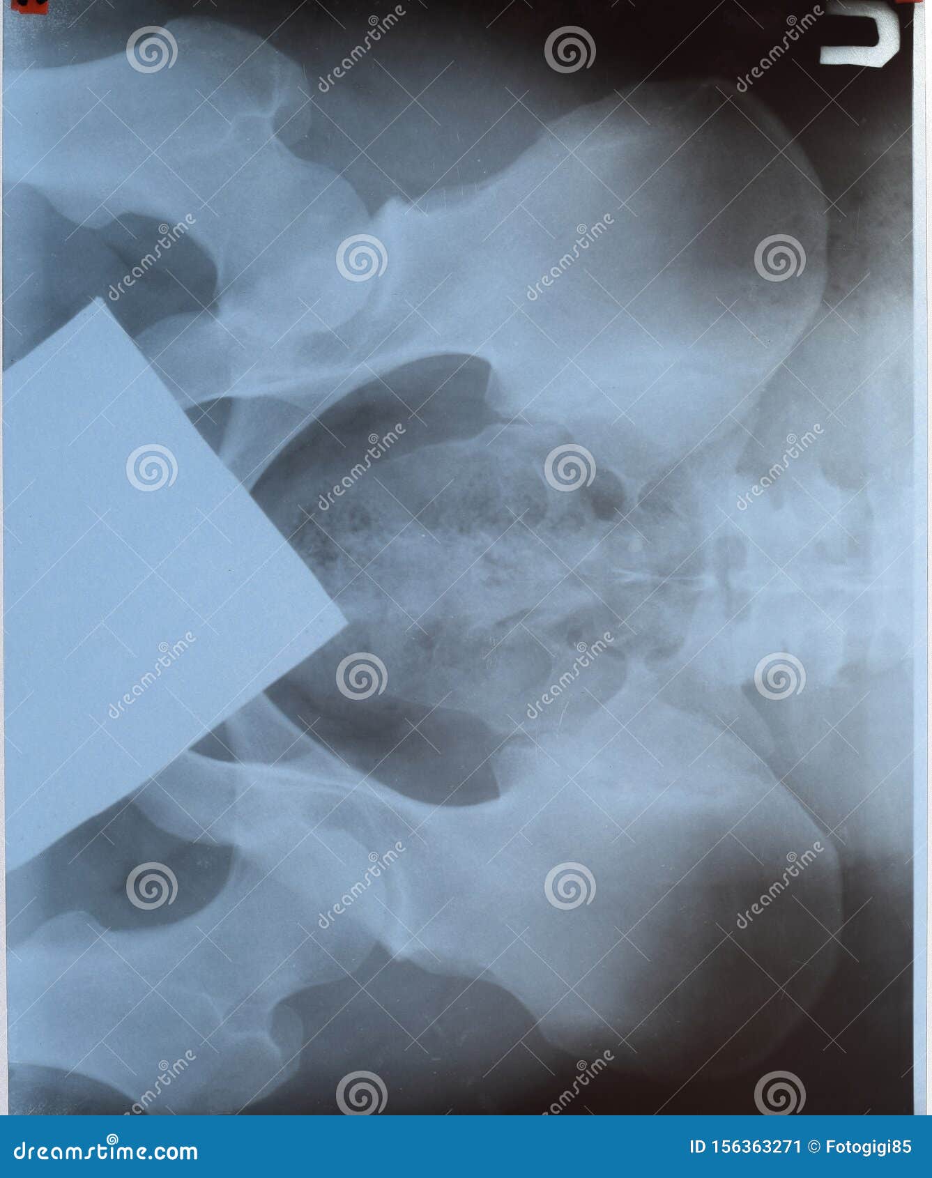 X-ray of the and Sacrum. X-ray Stock Image - Image of crest, arthritis ...