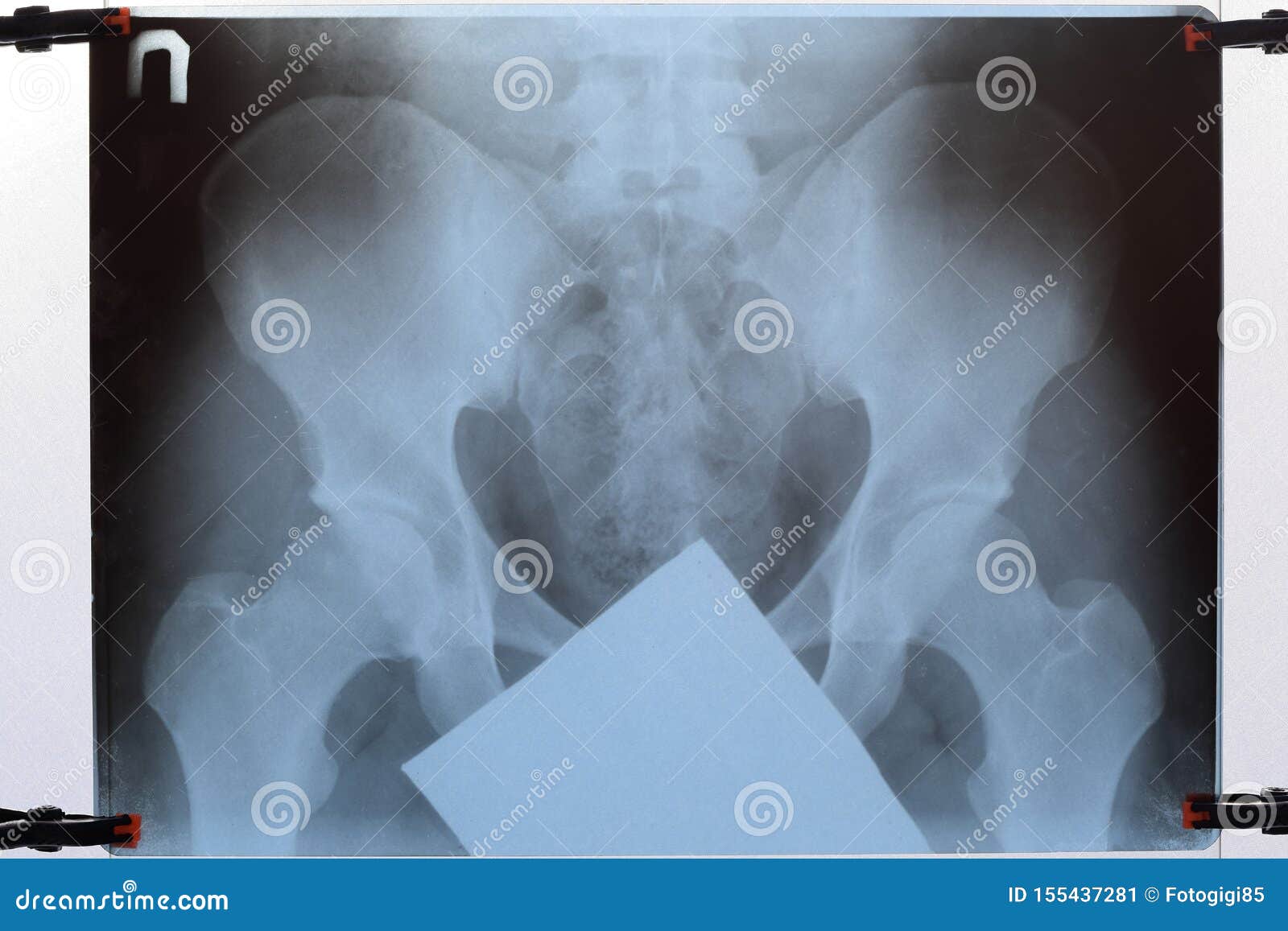 X-ray of the Pelvis and Sacrum. X-ray Stock Image - Image of film, exam ...