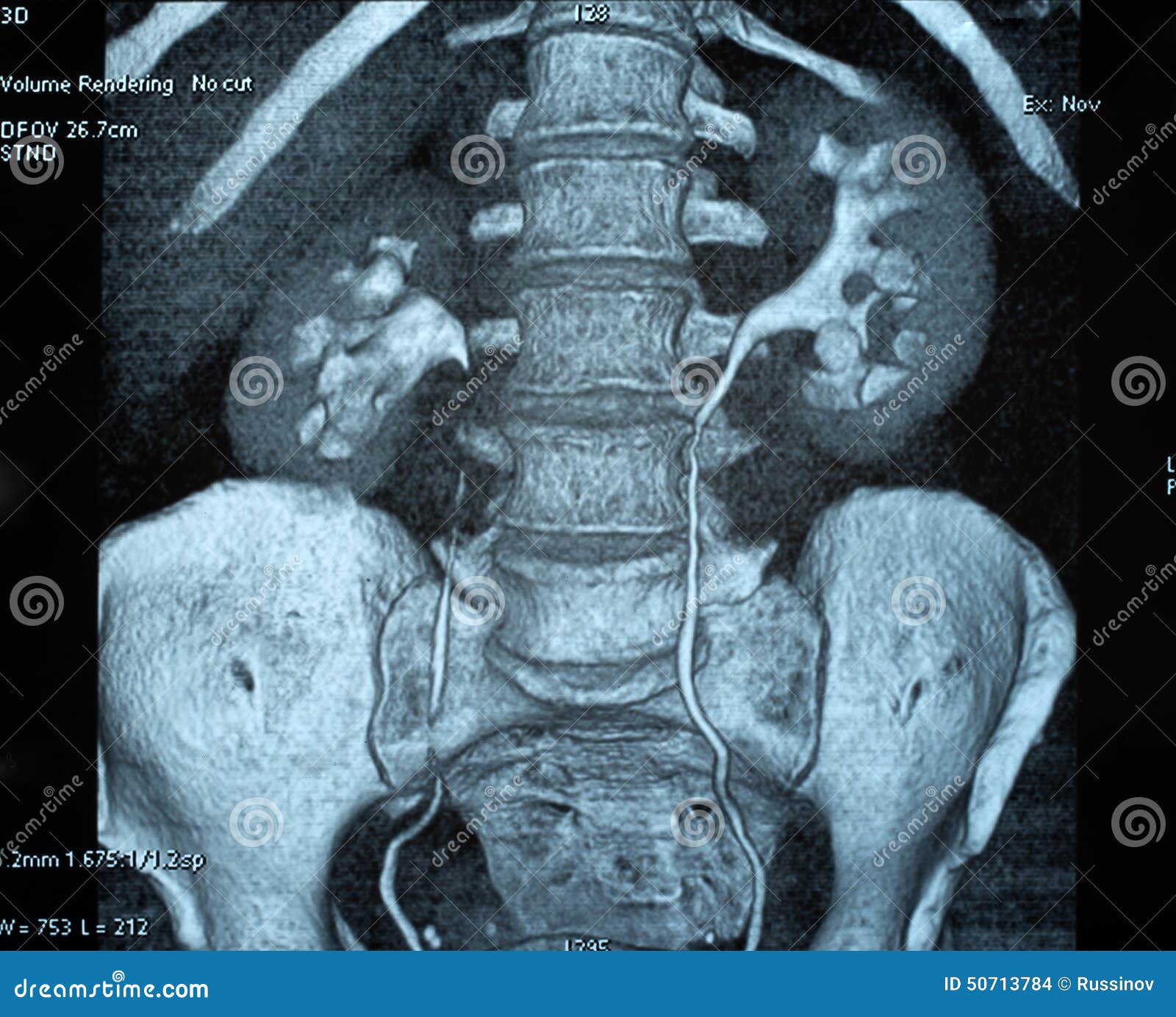 X-ray of the Pelvis and Spinal Column Stock Photo - Image of adult ...