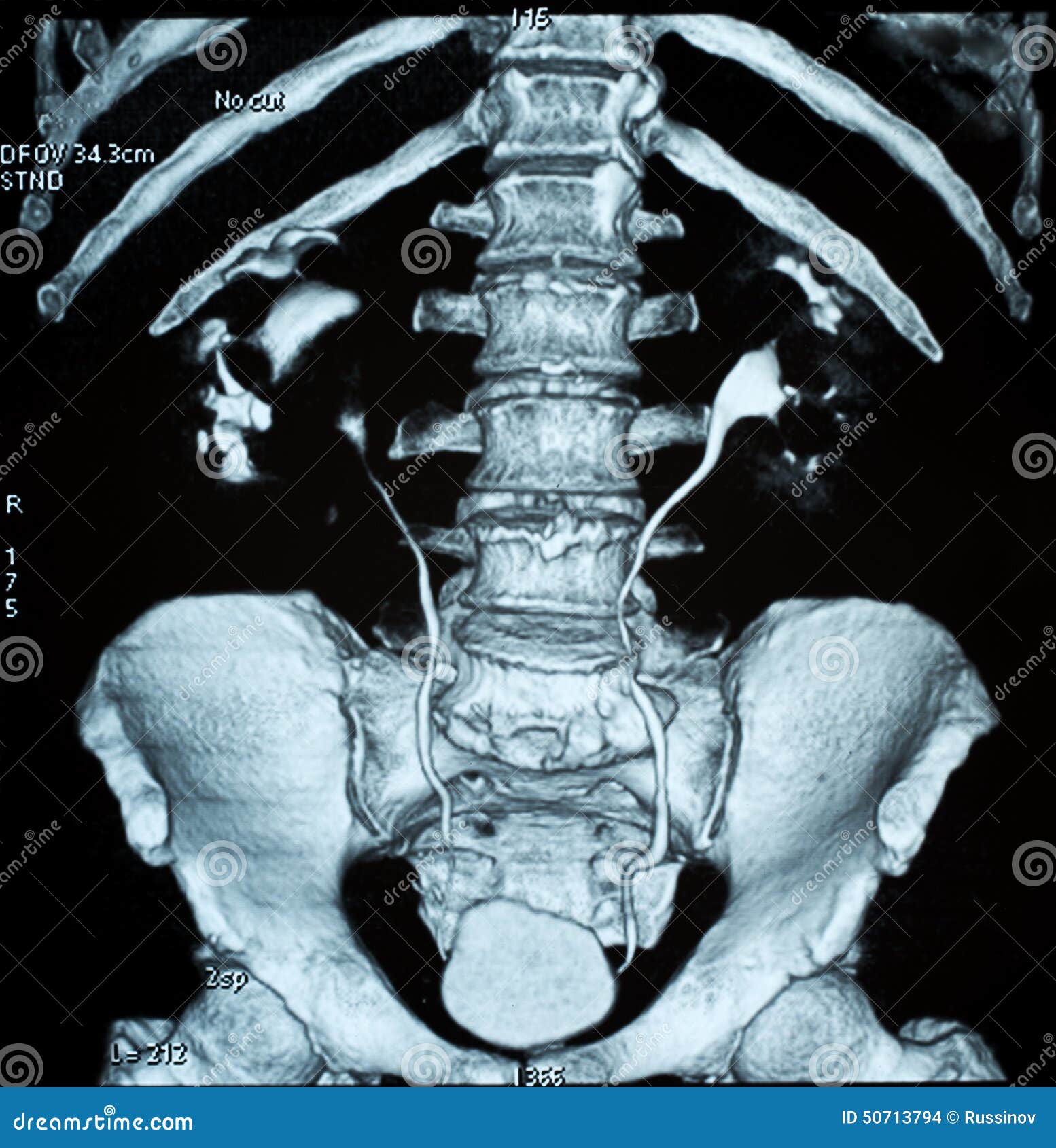 X-ray of the Pelvis and Spinal Column Stock Photo - Image of health ... X-ray of the Pelvis and Spinal Column Stock Photo - Image of health ...