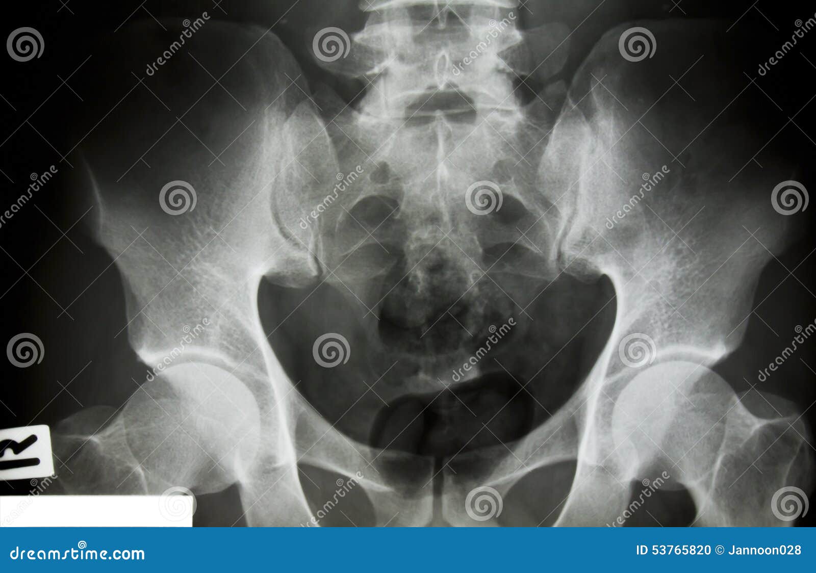 X-ray of the pelvis stock photo. Image of injury, clinical - 53765820