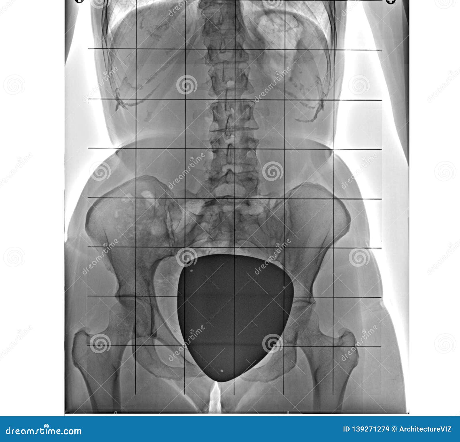 X-ray Of The Pelvis And Spinal Column Of A Woman Stock Image ...