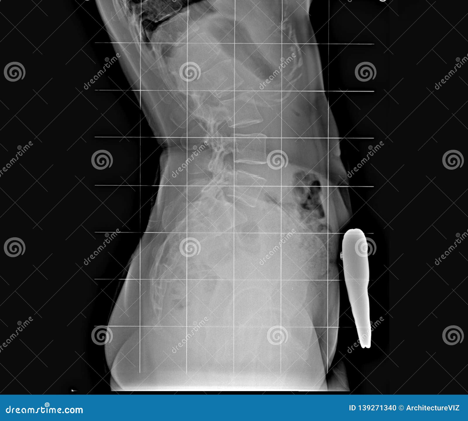Pelvis Lateral View X Ray