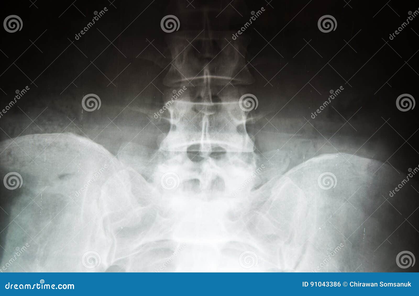 X-ray of the pelvis stock photo. Image of science, radiography - 91043386