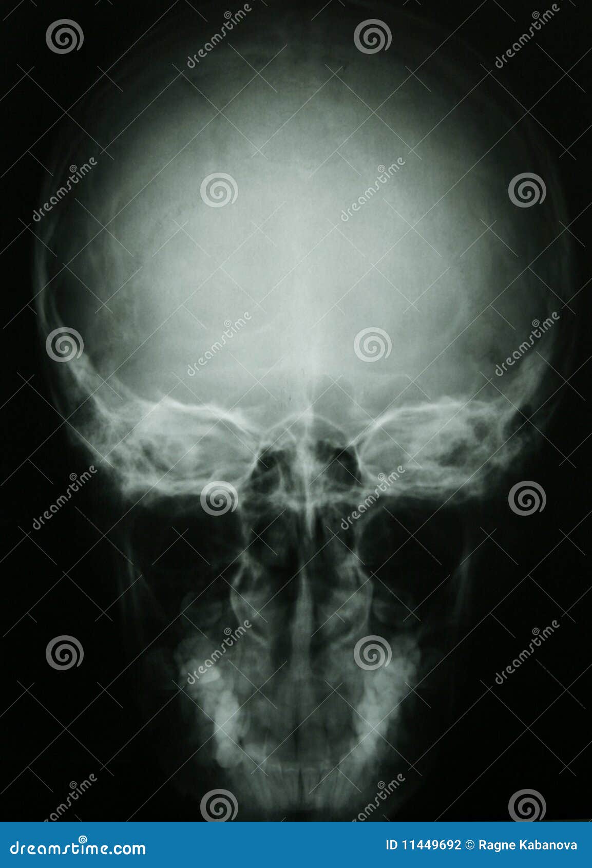 X-ray Photo of a Human Skull Stock Photo - Image of frontal, brain ...