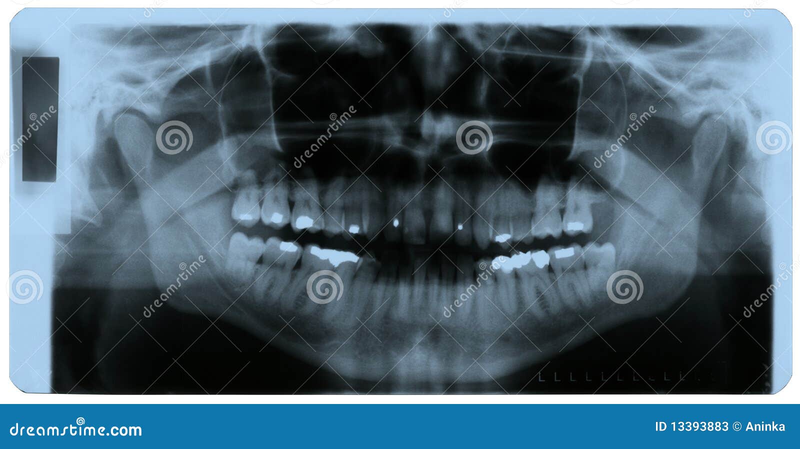 X-ray photo of human teeth stock image. Image of metal - 13393883