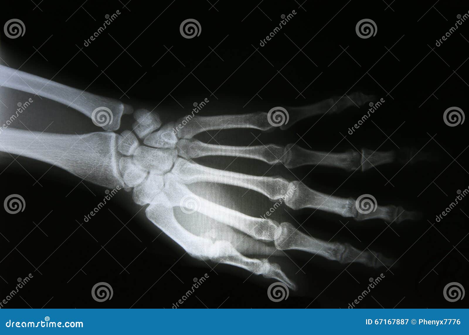 X-ray Photos of Bone Fracture Patients Stock Image - Image of finger ...