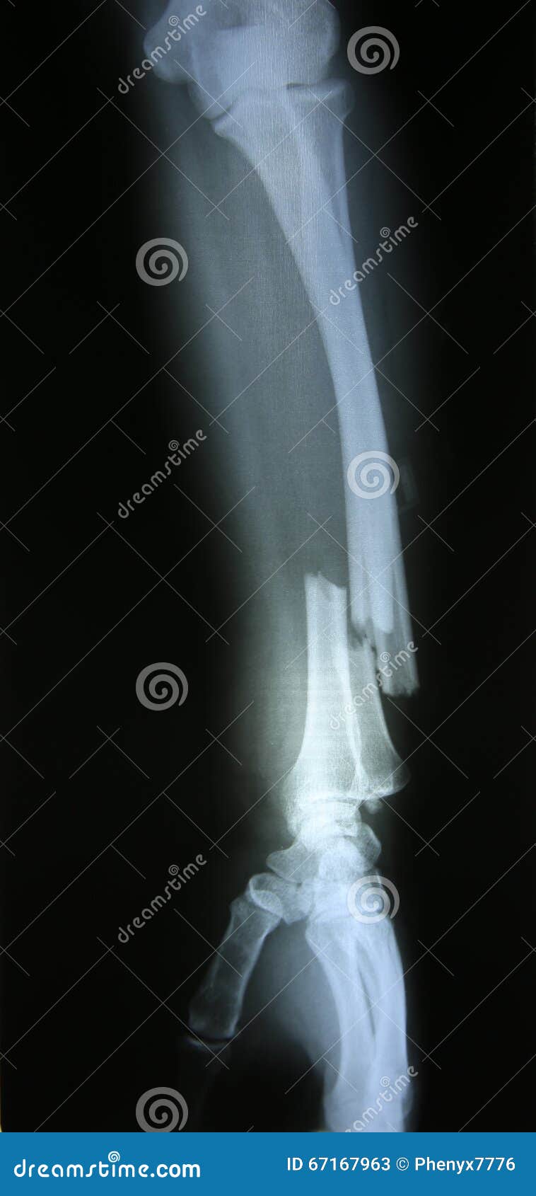 X-ray Photos of Bone Fracture Patients Stock Image - Image of anatomy ...