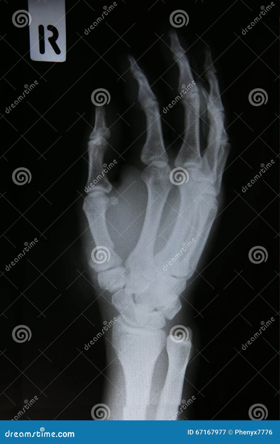 X-ray Photos of Bone Fracture Patients Stock Image - Image of bone ...