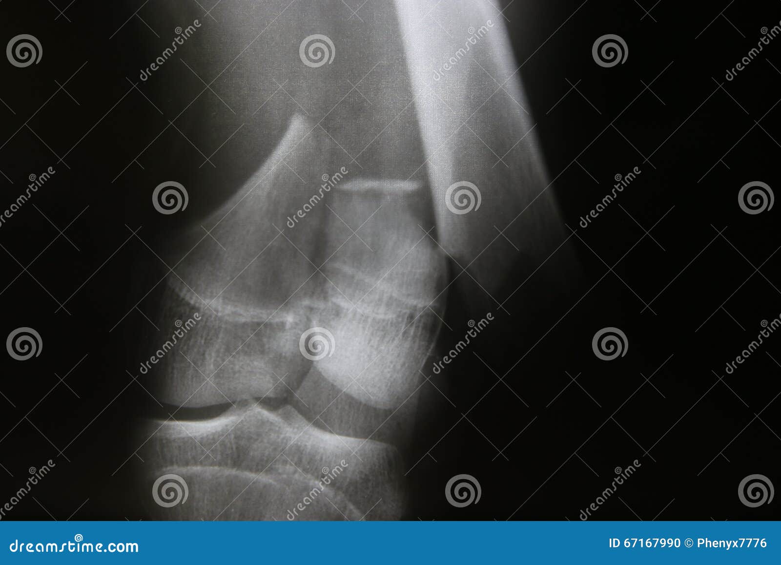 X-ray Photos of Bone Fracture Patients Stock Photo - Image of diagnosis ...