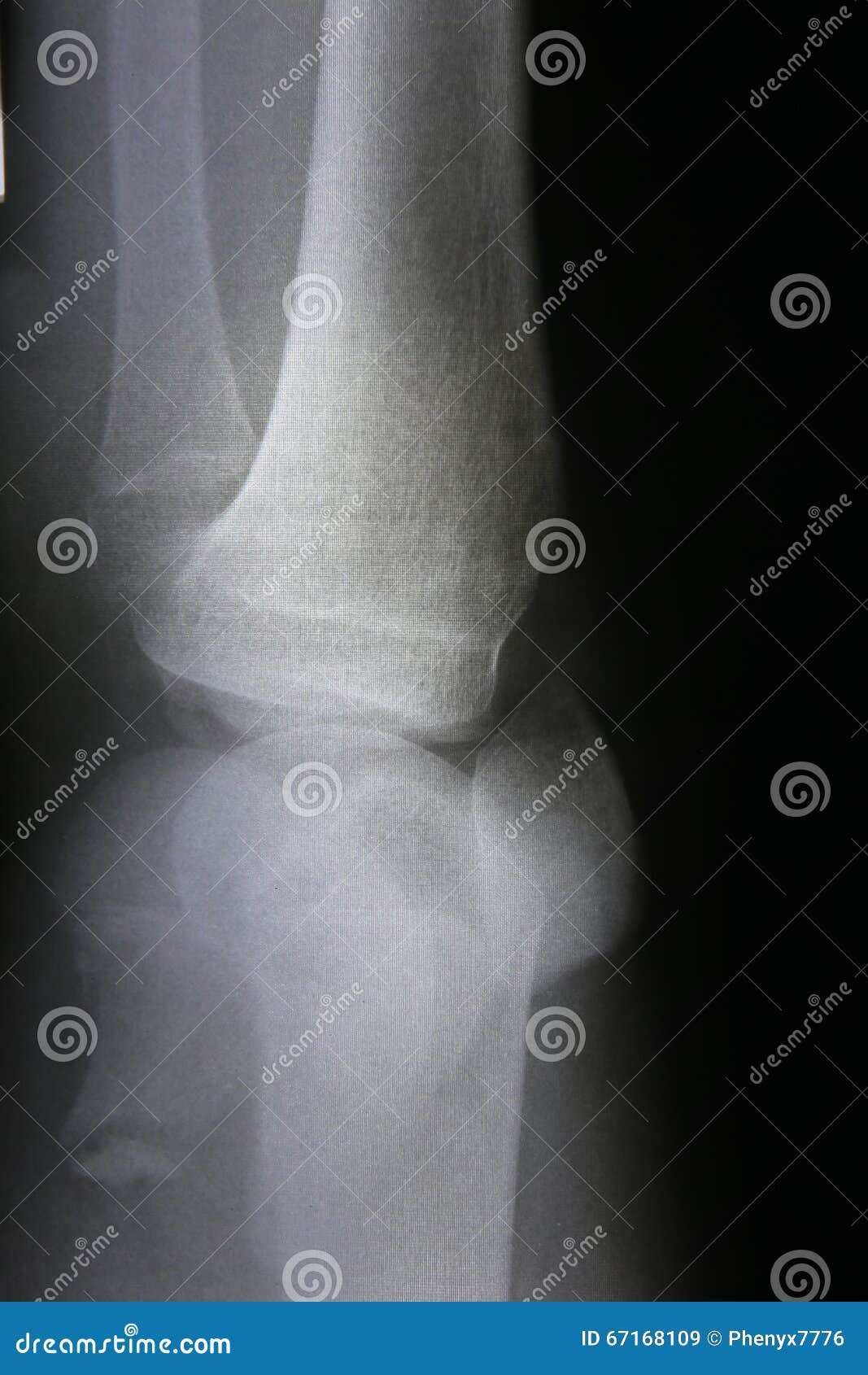 X-ray Photos of Bone Fracture in Patients Stock Image - Image of ...