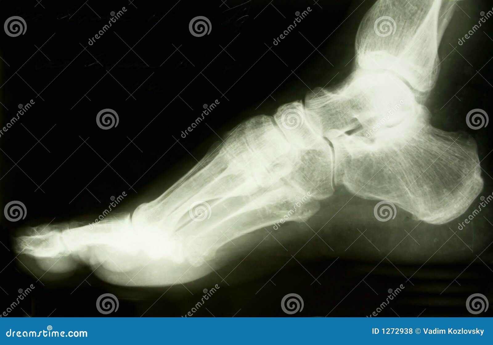 X-ray picture stock photo. Image of diagnosis, tendon - 1272938