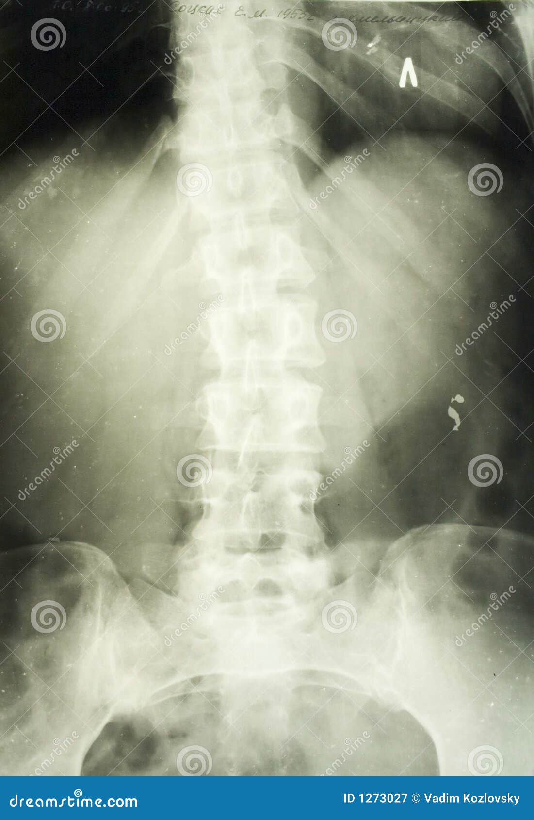 X-ray picture stock image. Image of hospital, joint, fracture - 1273027