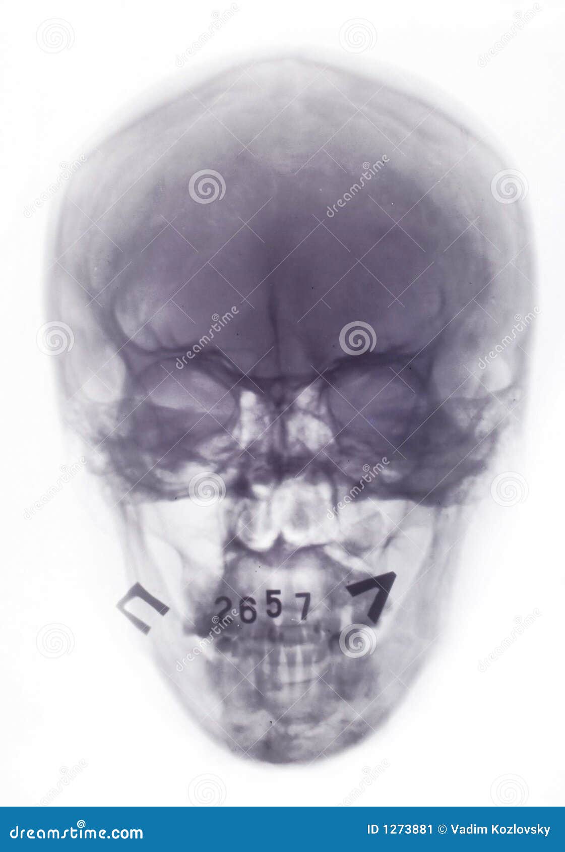 Tibia X-ray Picture Royalty-Free Stock Image | CartoonDealer.com #19208884