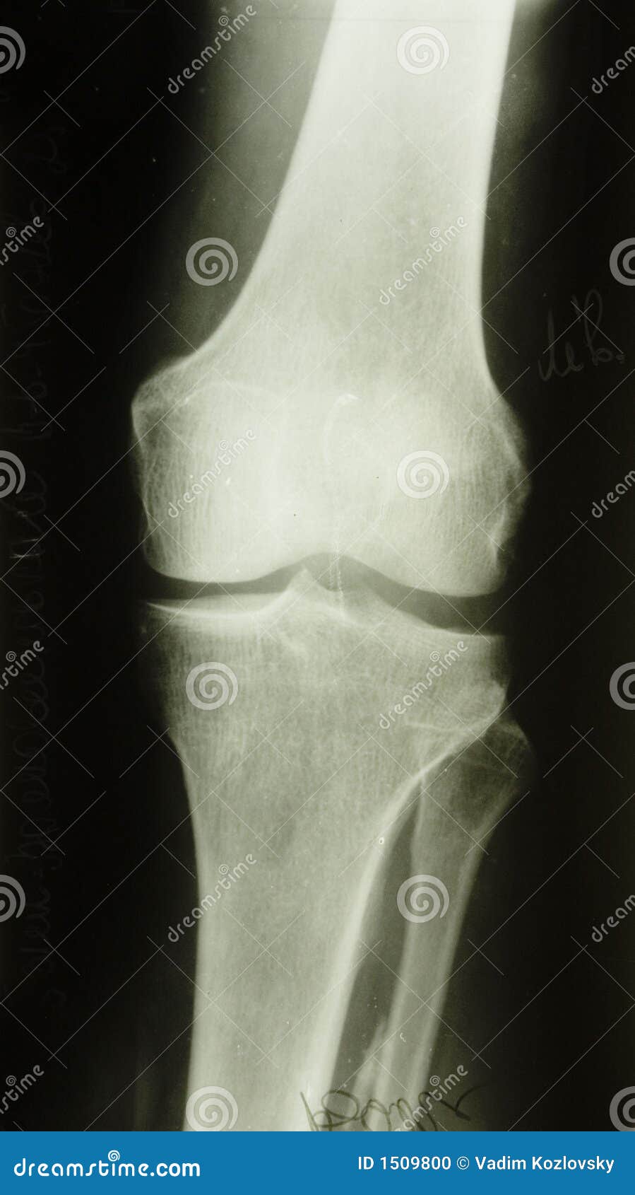 Chest Deformity, Birth Defect. Strong Deformity. Pectus Excavatus ...