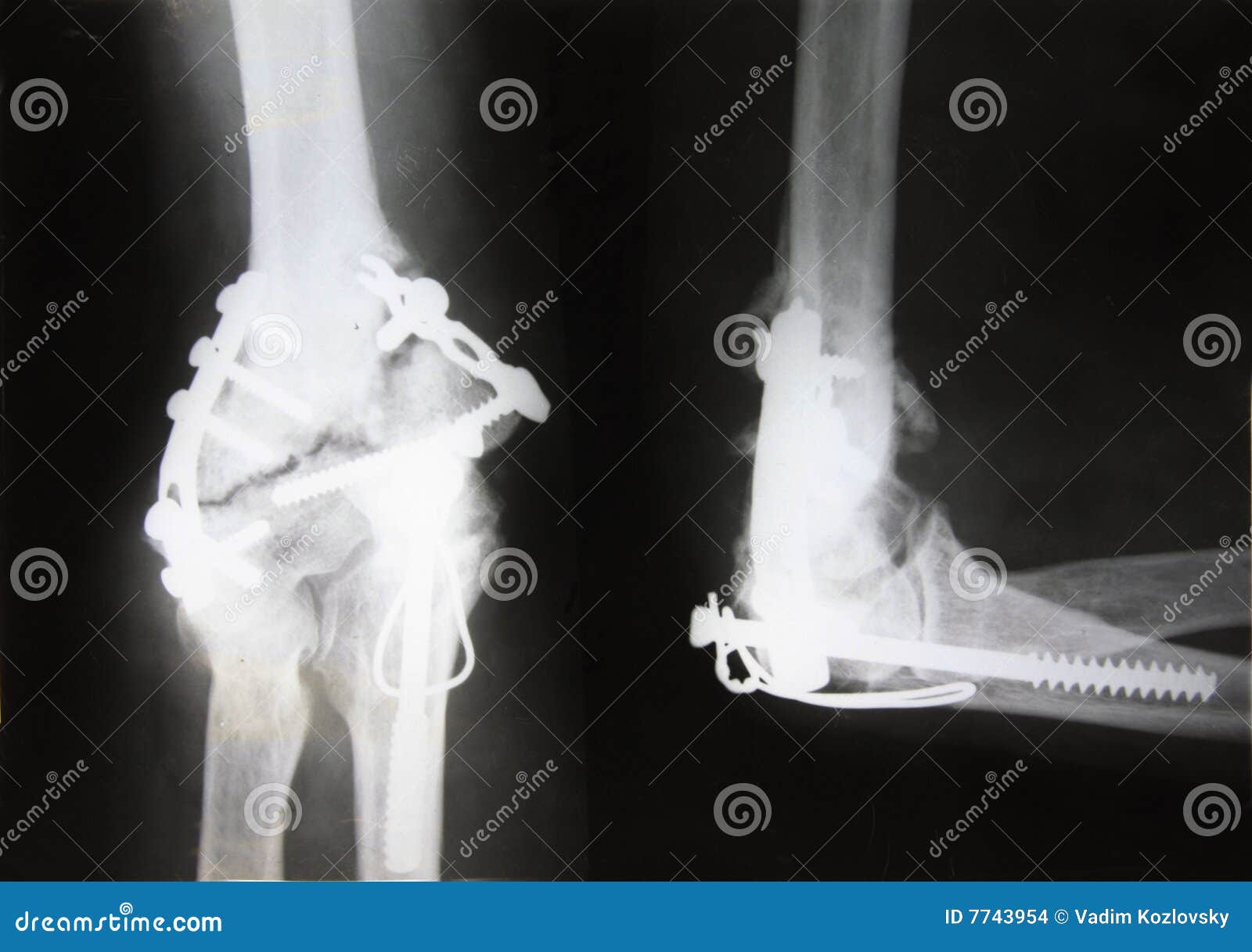 Metal Fixators Stock Photos - Free & Royalty-Free Stock Photos from ...