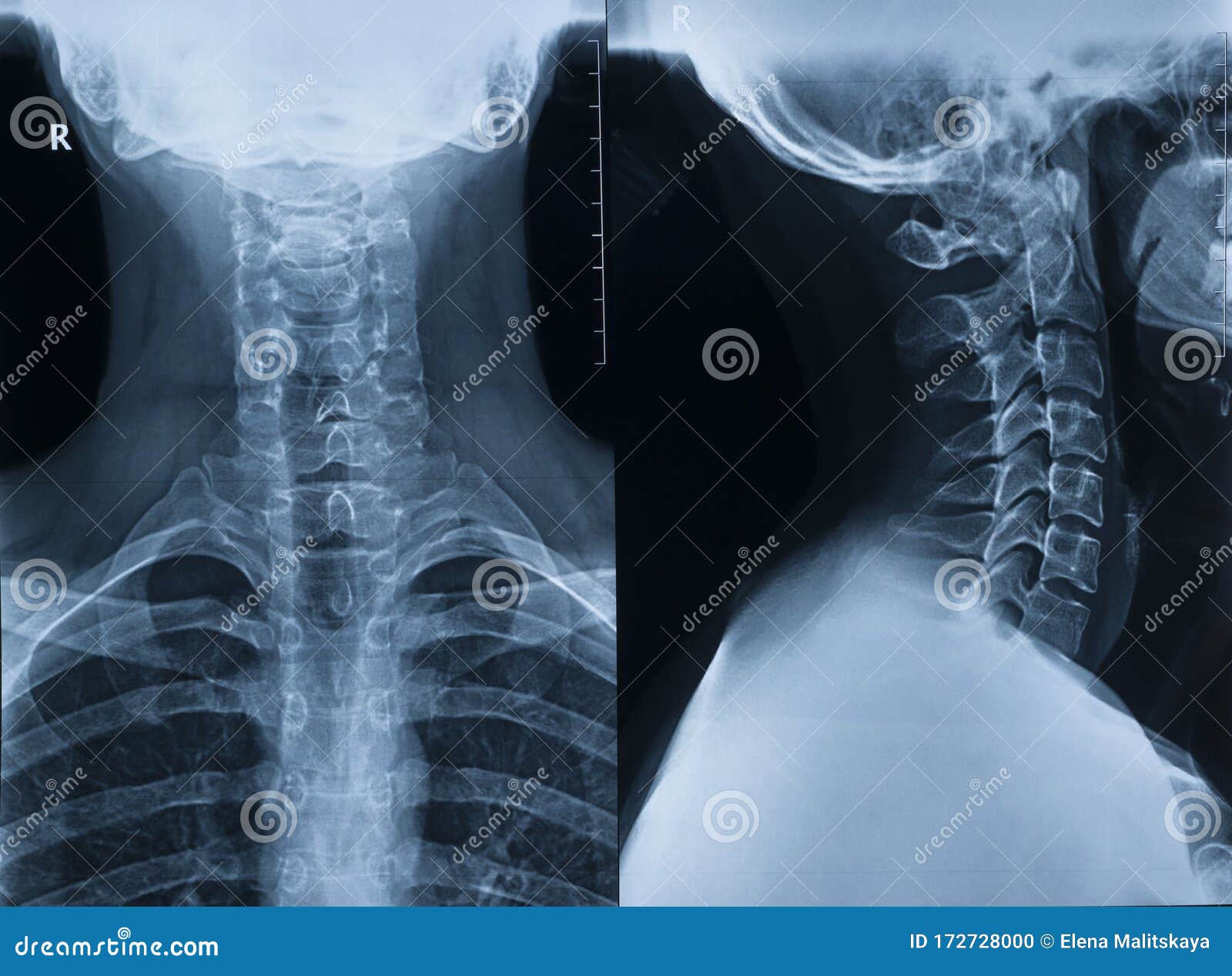 X-ray Picture of the Cervical Spine of a Man in Two Projections Stock ...