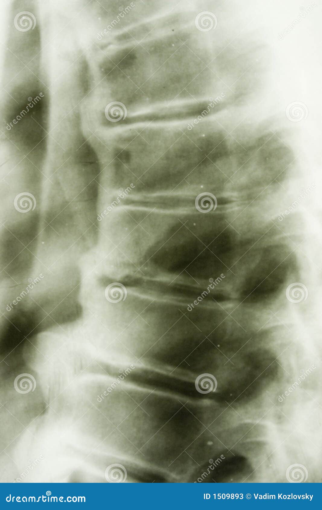 Chest Deformity, Birth Defect. Strong Deformity. Pectus Excavatus ...