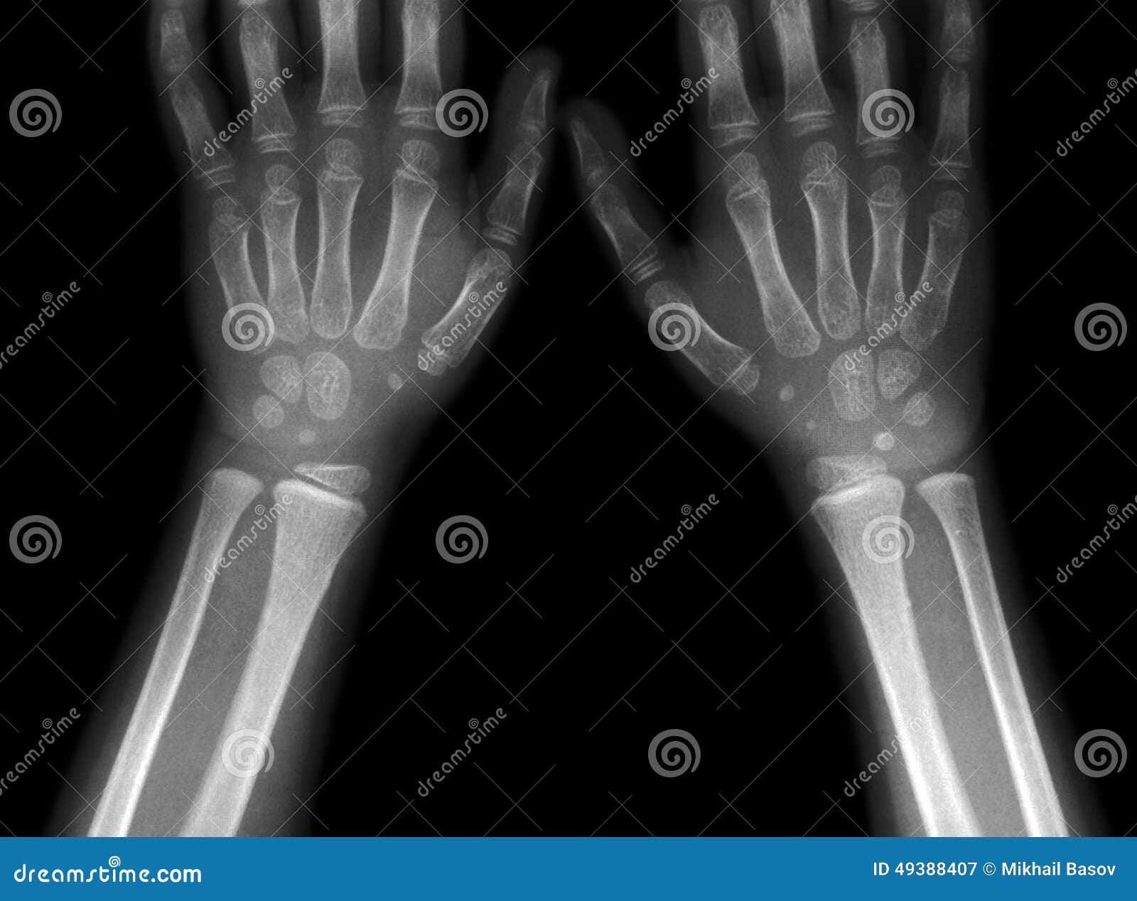 X-ray picture of hands stock image. Image of skeleton - 49388407