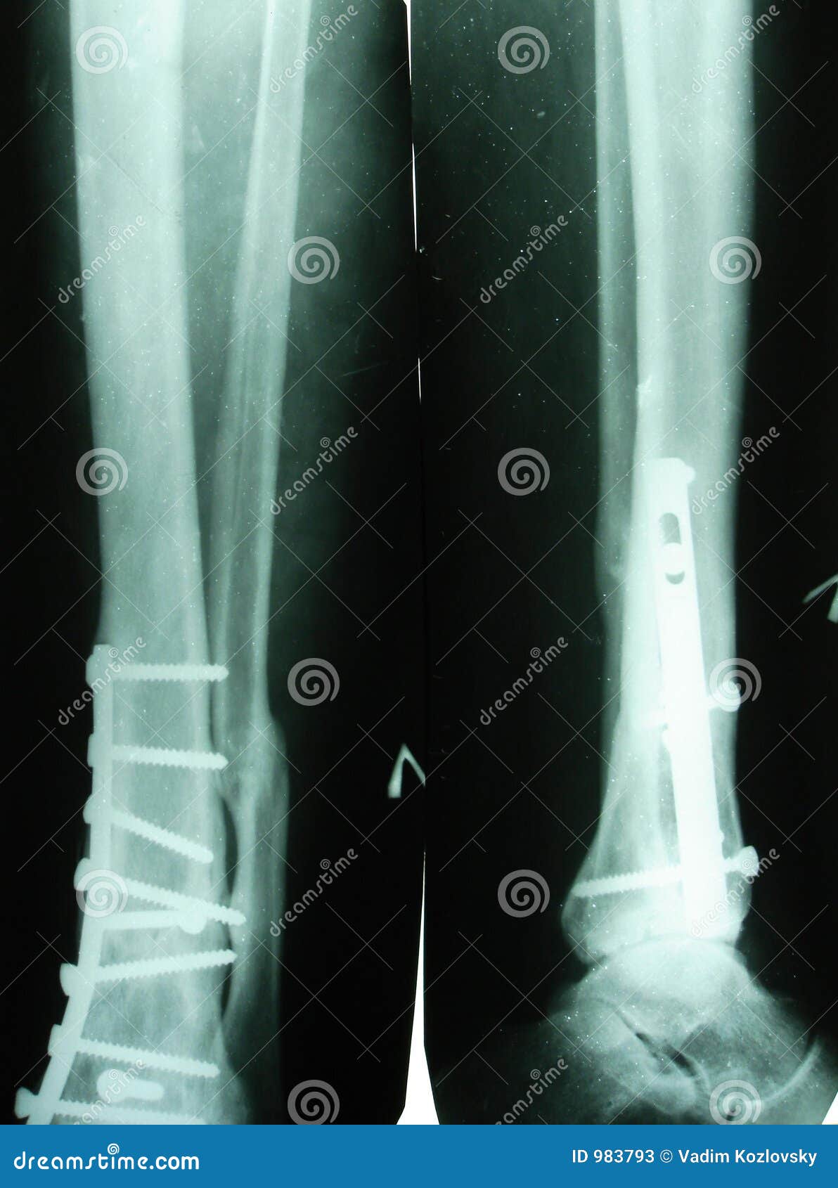 X-ray picture of human leg stock image. Image of isolated - 983793