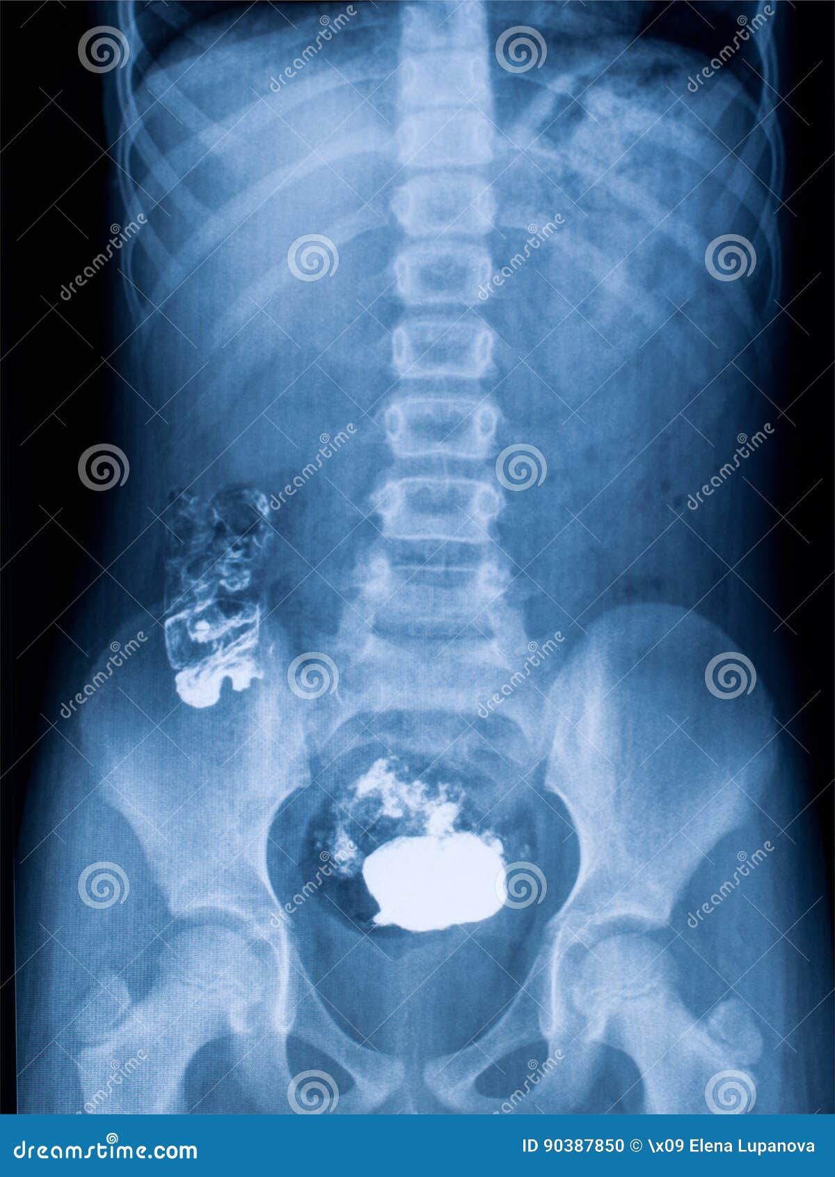X-ray Picture of the Intestine with Foreign Bodies Stock Photo - Image ...