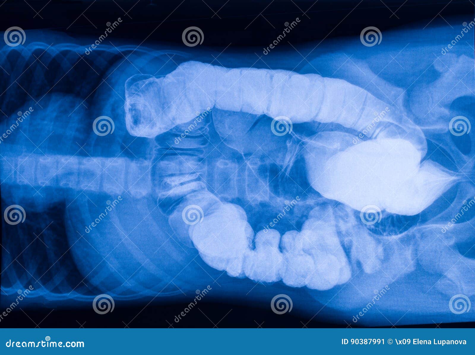 X-ray Picture of the Intestine with Foreign Bodies Stock Image - Image ...