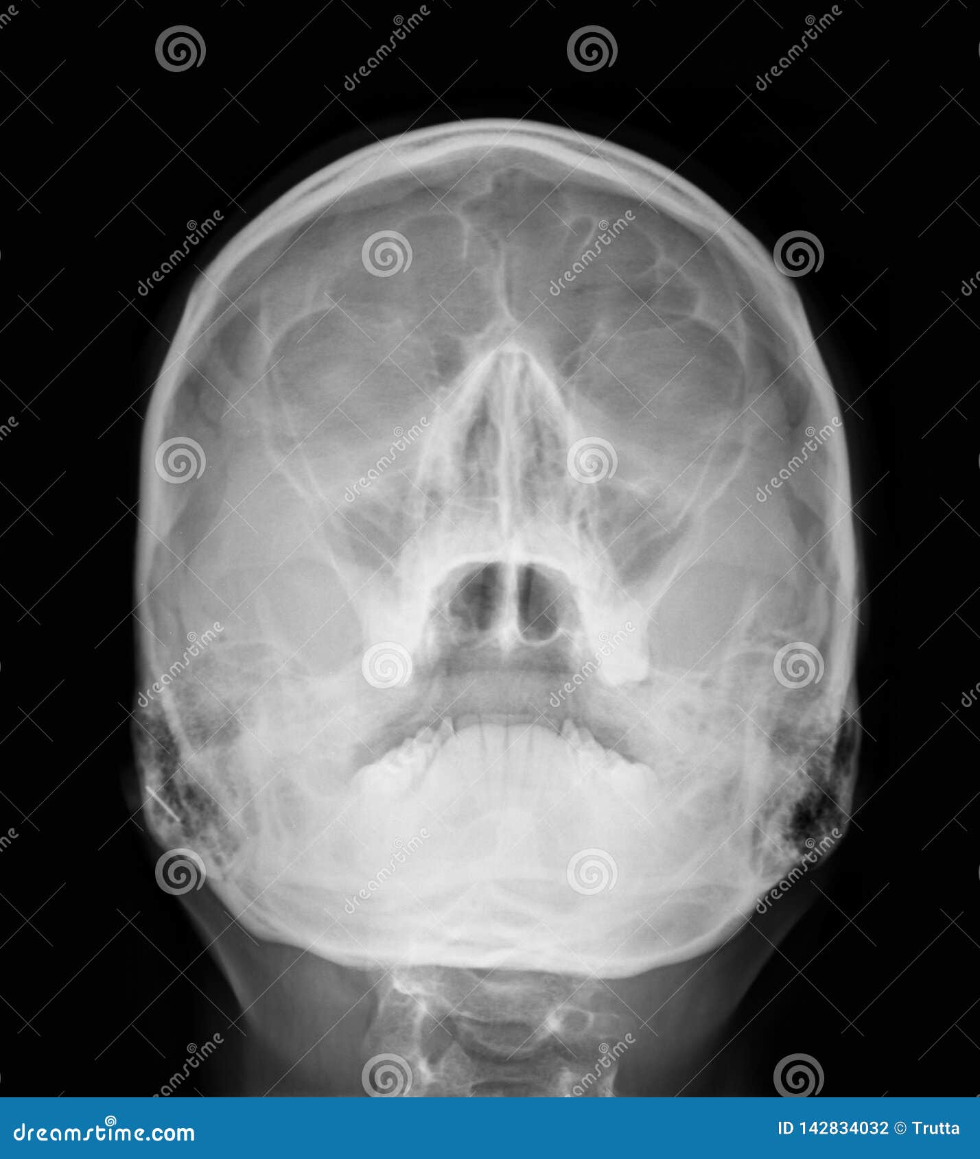 X-ray picture - Sinus stock photo. Image of medical - 142834032