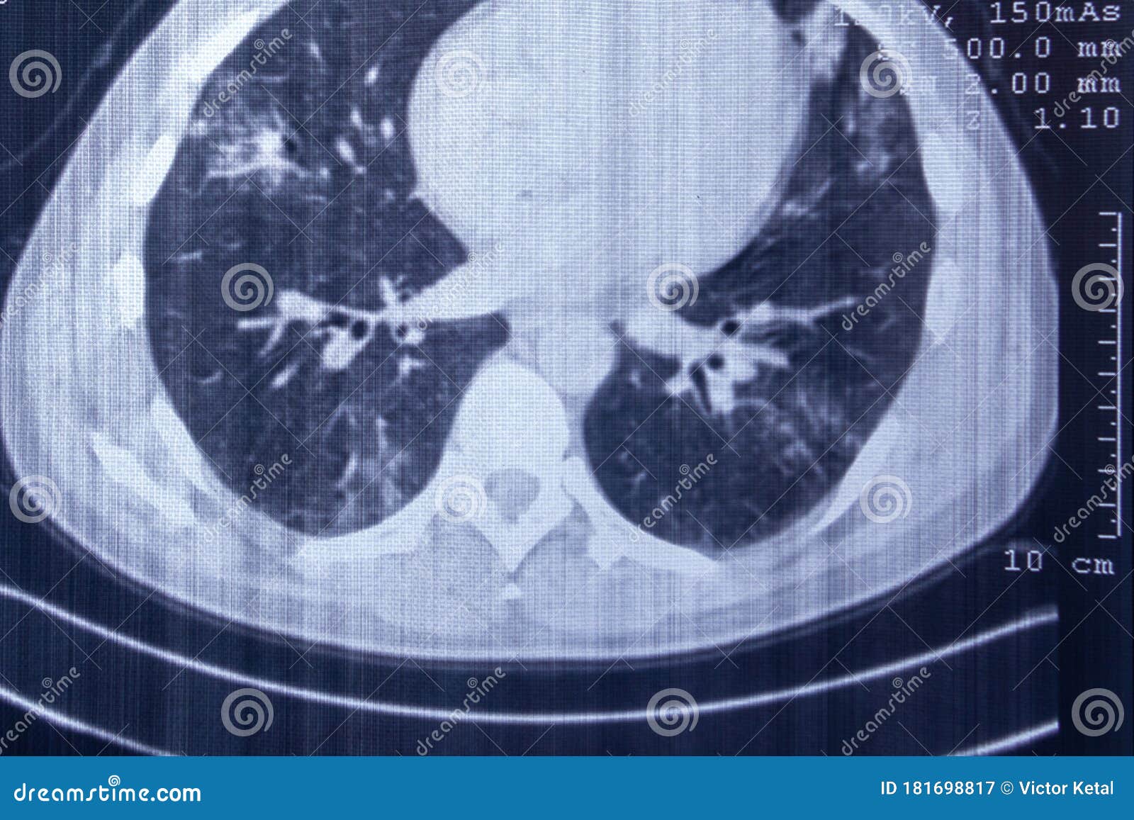 X-ray of Pneumonia-affected Lungs. CT Scan Stock Image - Image of ...