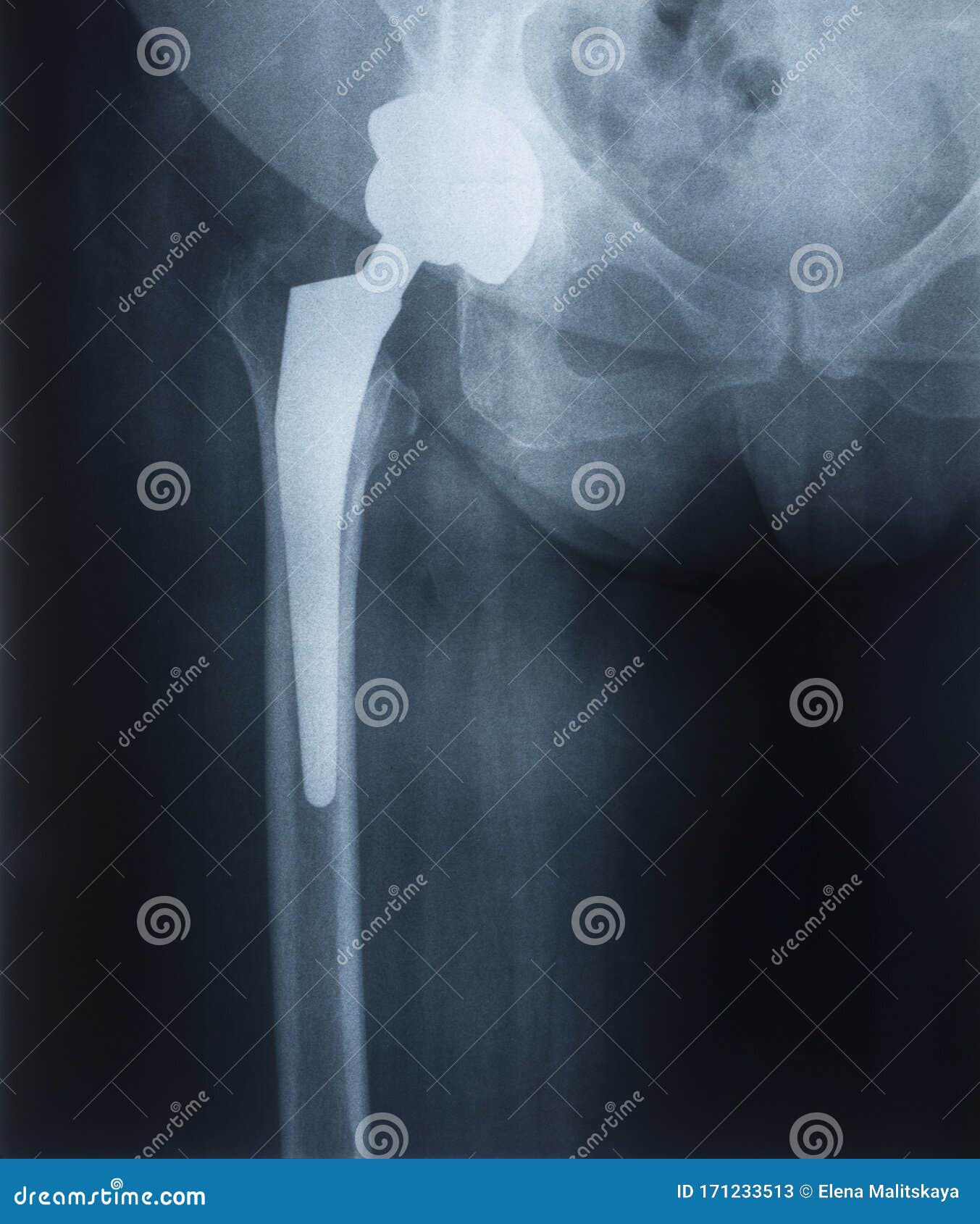 X-ray of a Prosthesis of a Female Hip Joint. Joint Endoprosthetics ...