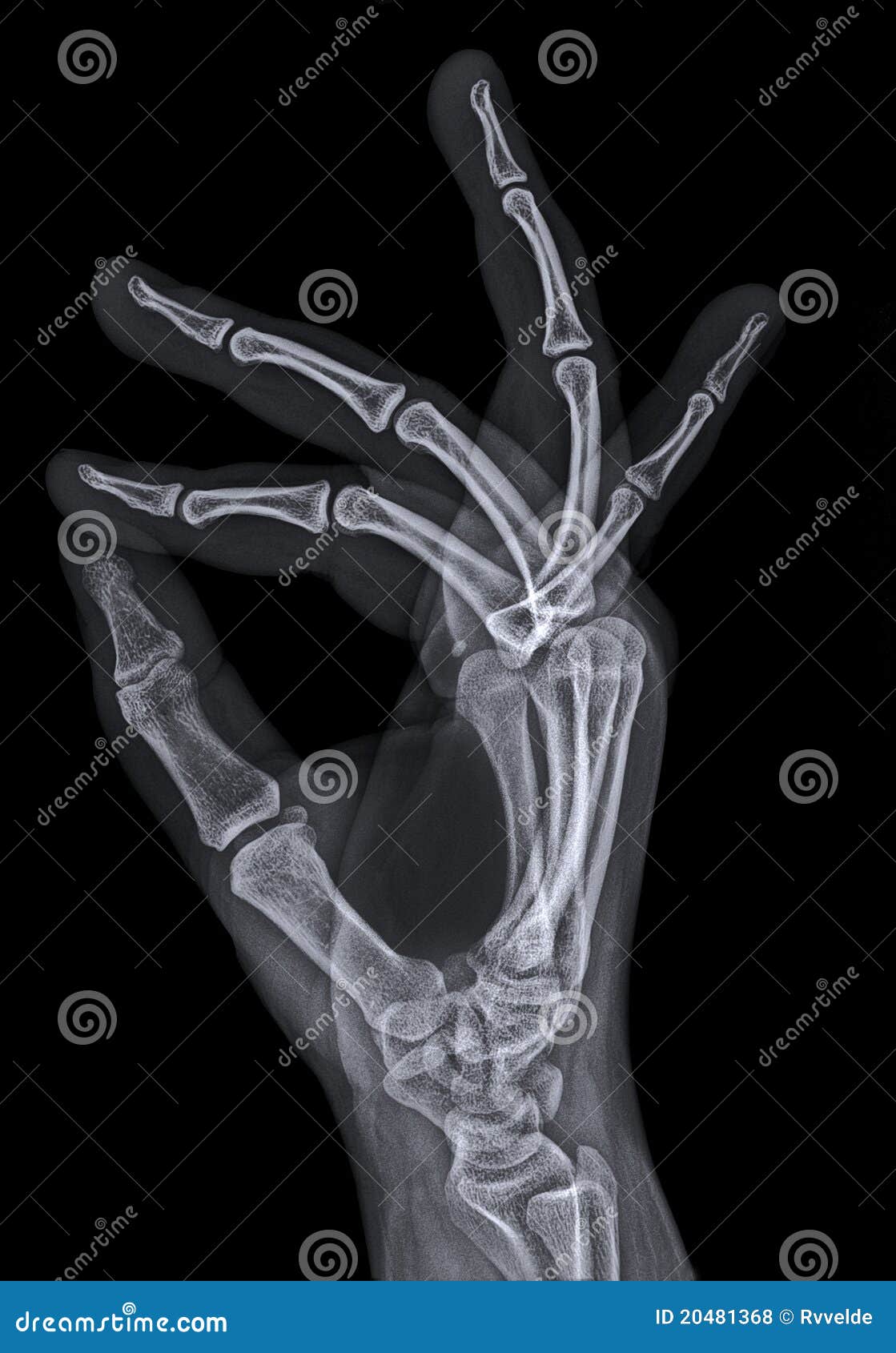 X Ray or Radiograph of Hand Stock Photo - Image of diagnose, index ...