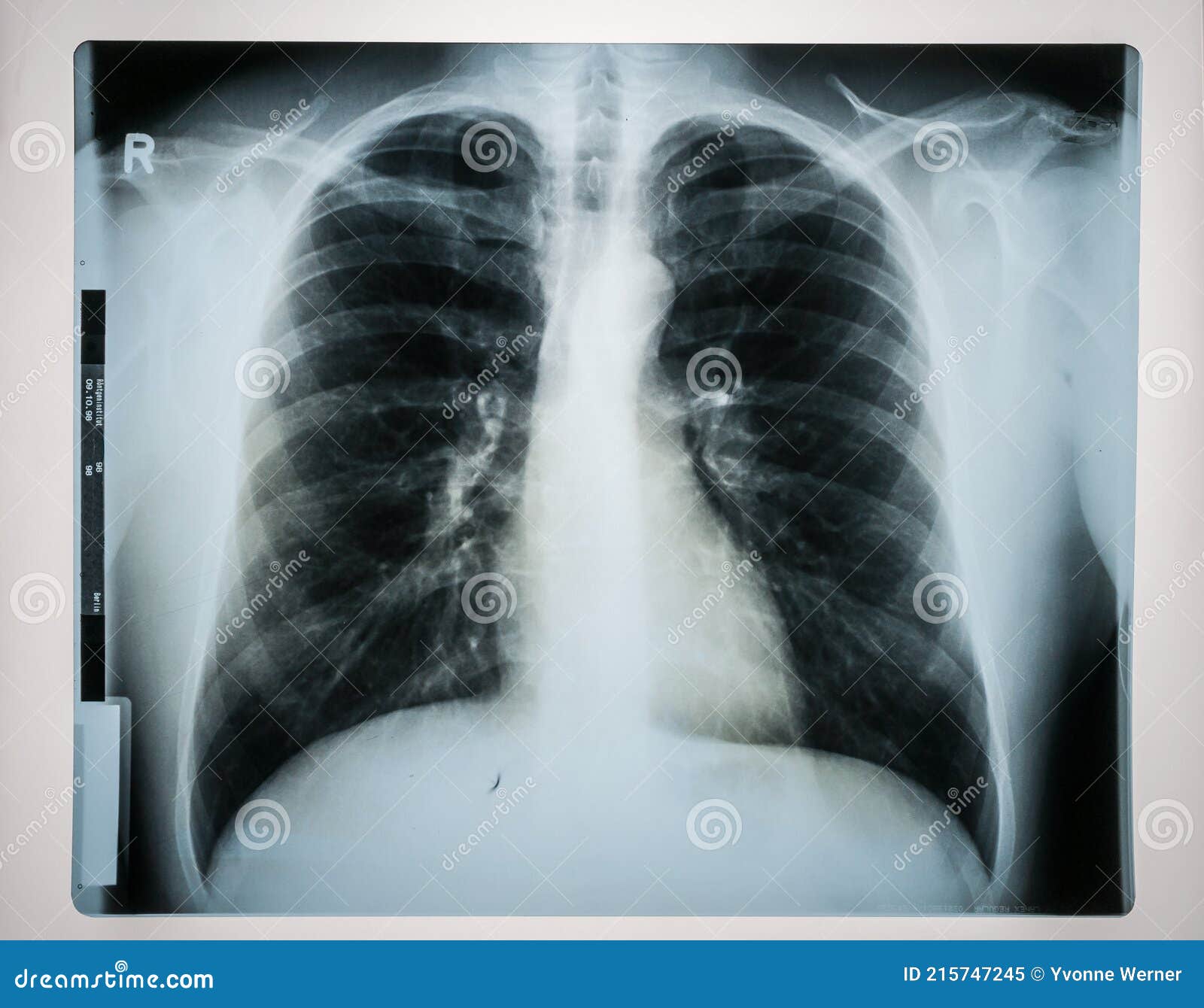 X-ray, Radiographs of a Lun Stock Image - Image of bone, hospital ...