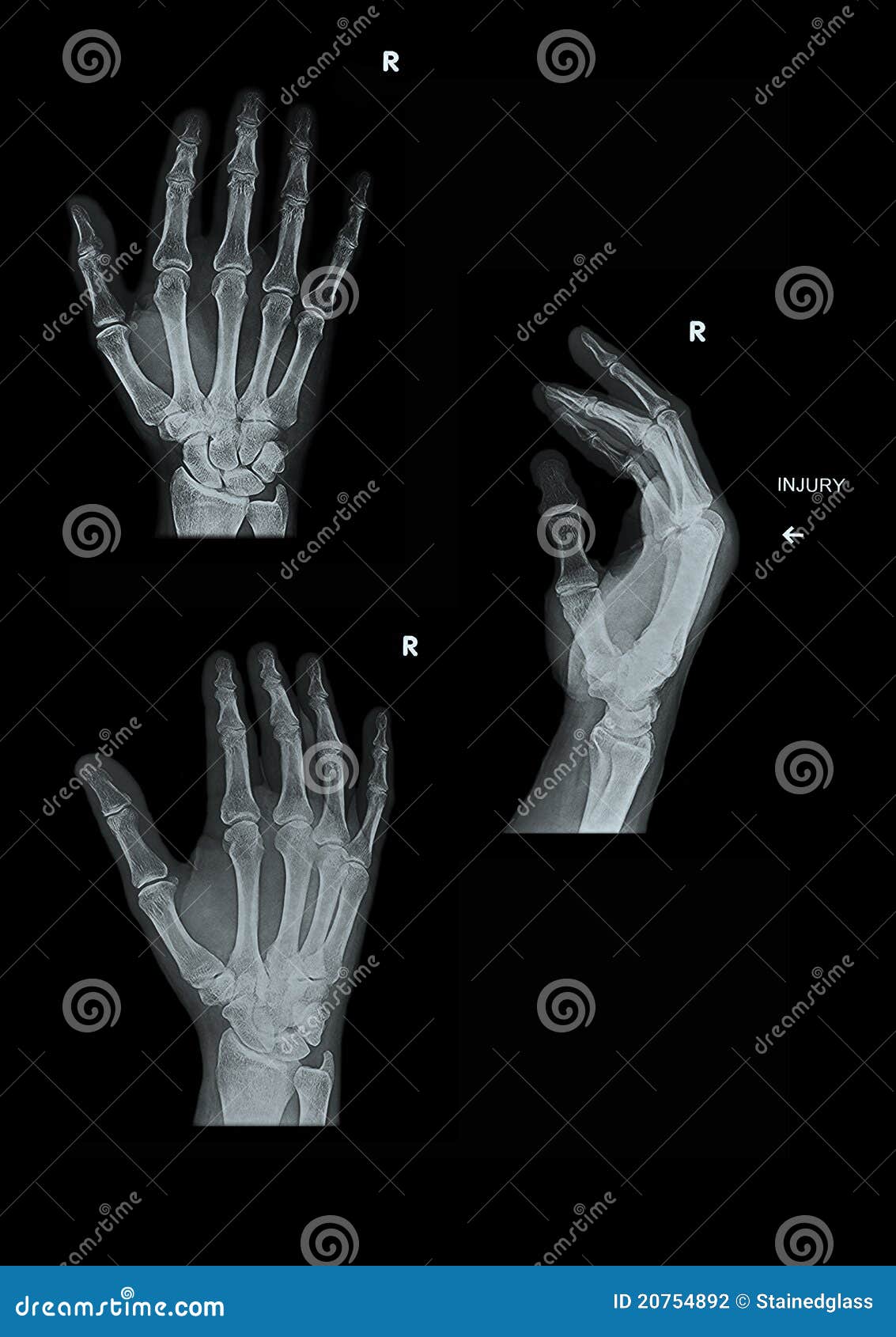 X-Ray Right Hand Set stock photo. Image of phalange, orthopaedic - 20754892