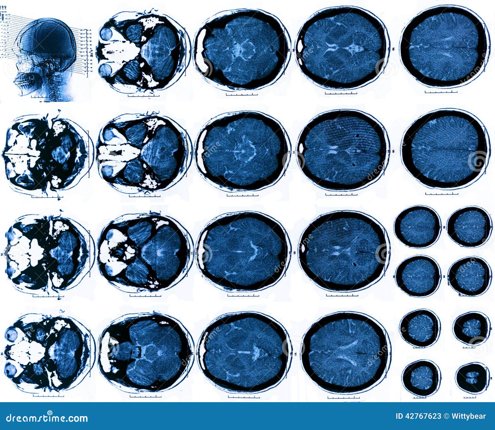 X-Ray scan human for brain stock image. Image of hospital - 42767623