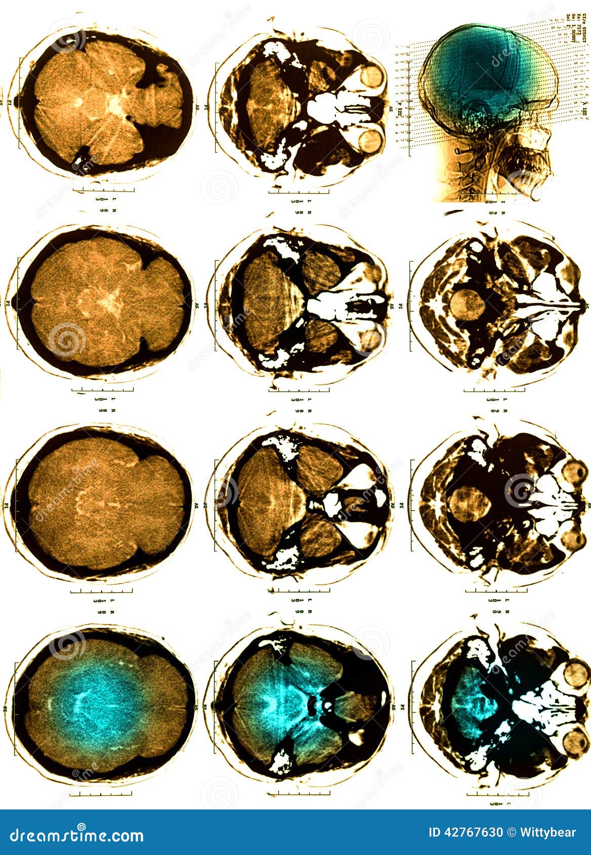 X-Ray Scan Human For Brain Stock Photography | CartoonDealer.com #42767630
