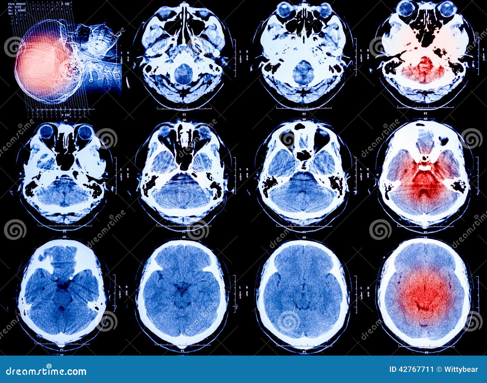 X-Ray scan human for brain stock image. Image of disease - 42767711