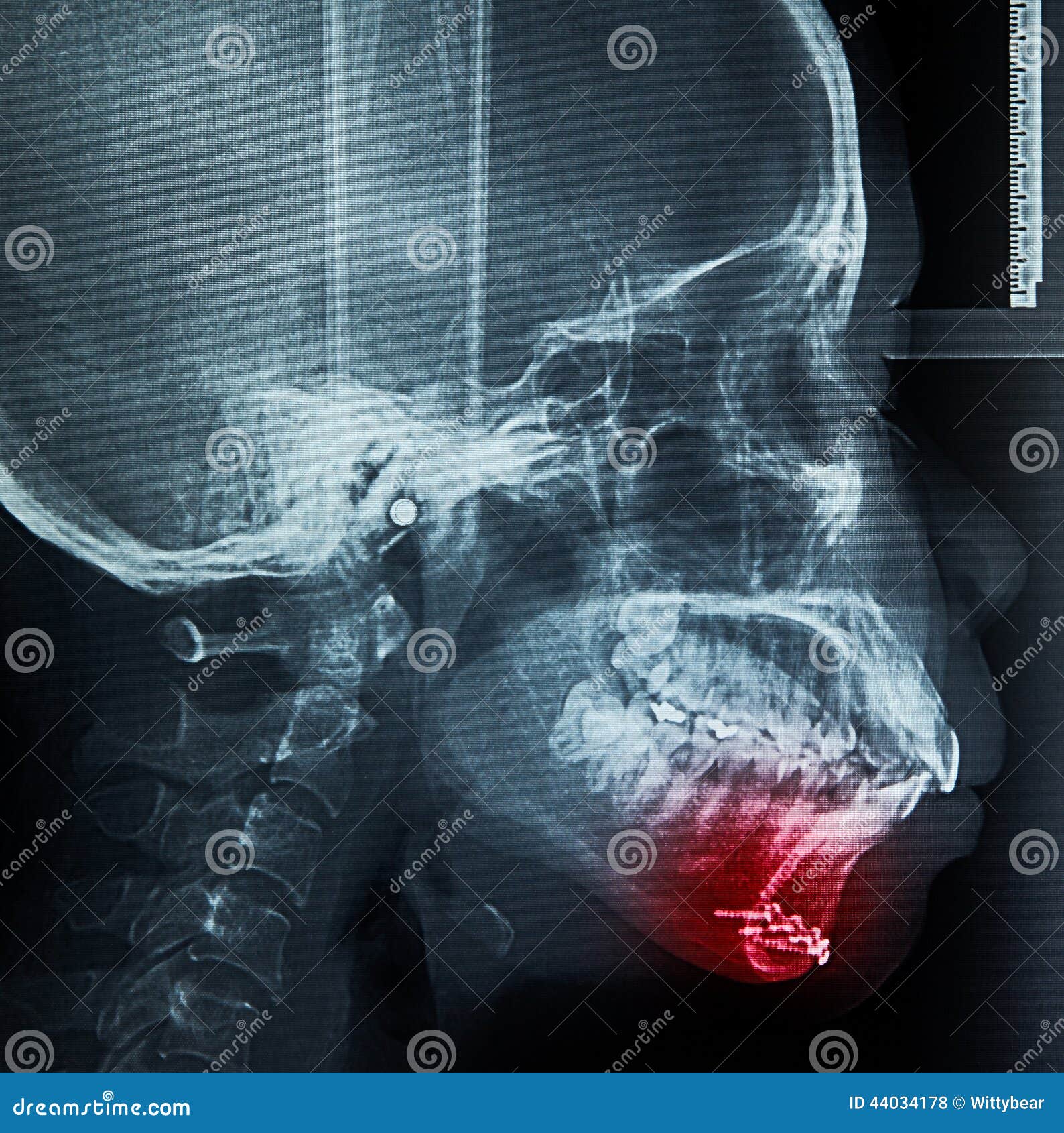 X-Ray scan human stock photo. Image of skeleton, medicine - 44034178