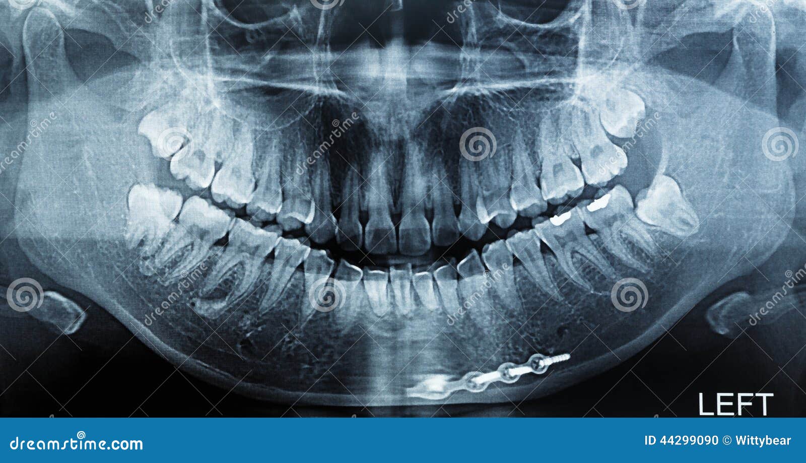 X-ray Scan Of Human Teeth Royalty-Free Stock Image | CartoonDealer.com ...