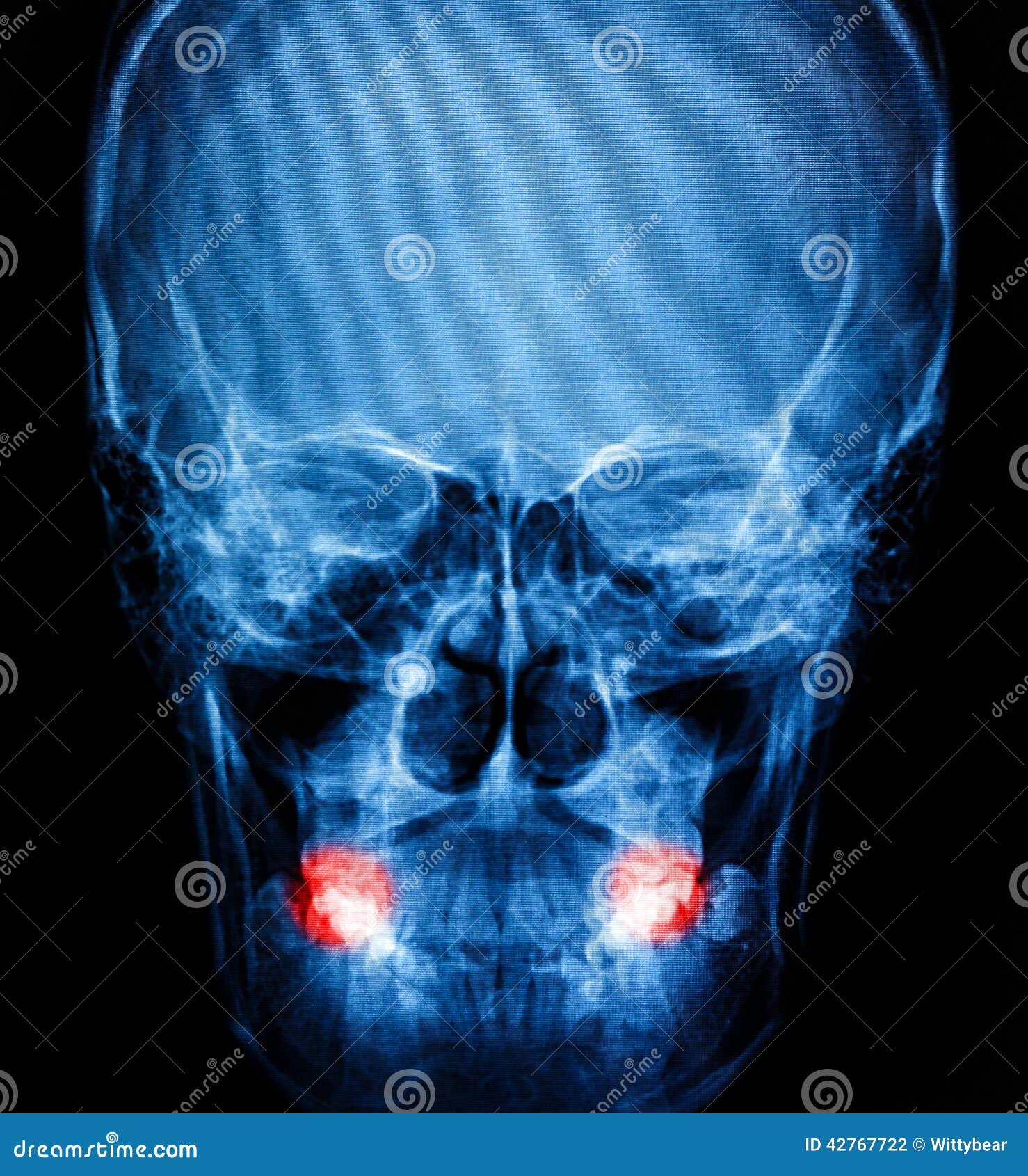 X-Ray scan human for teeth stock photo. Image of body - 42767722