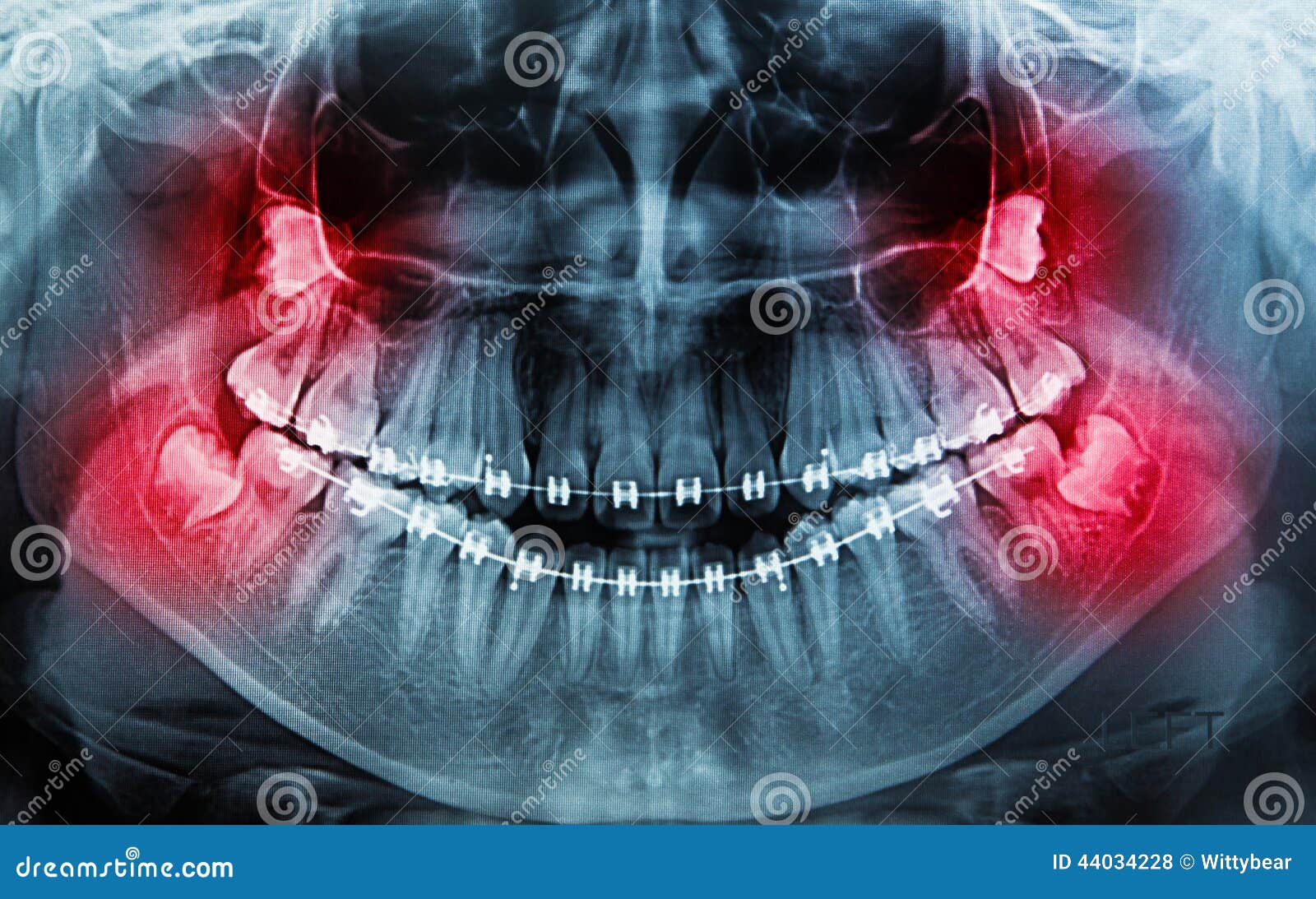 X-Ray scan human for teeth stock photo. Image of arthritis - 44034228