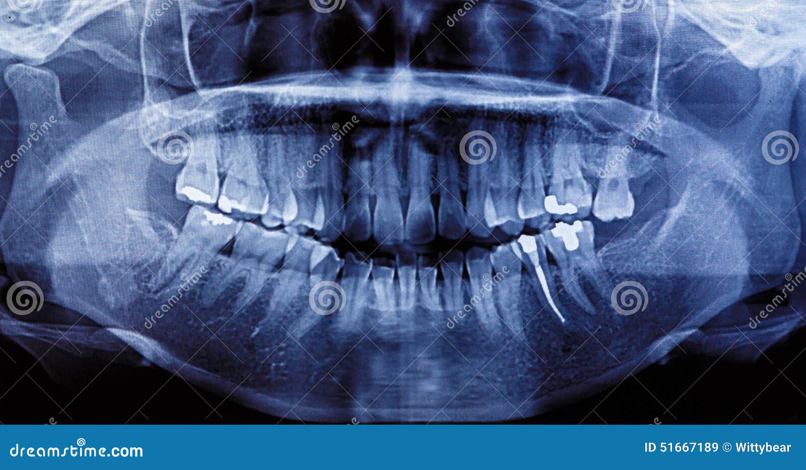 X-Ray scan human for teeth stock image. Image of collage - 51667189