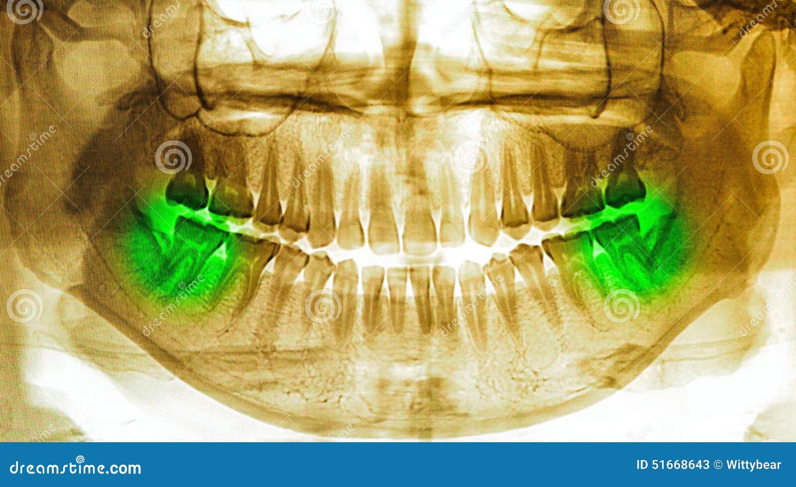 X-Ray scan human for teeth stock image. Image of elbow - 51668643