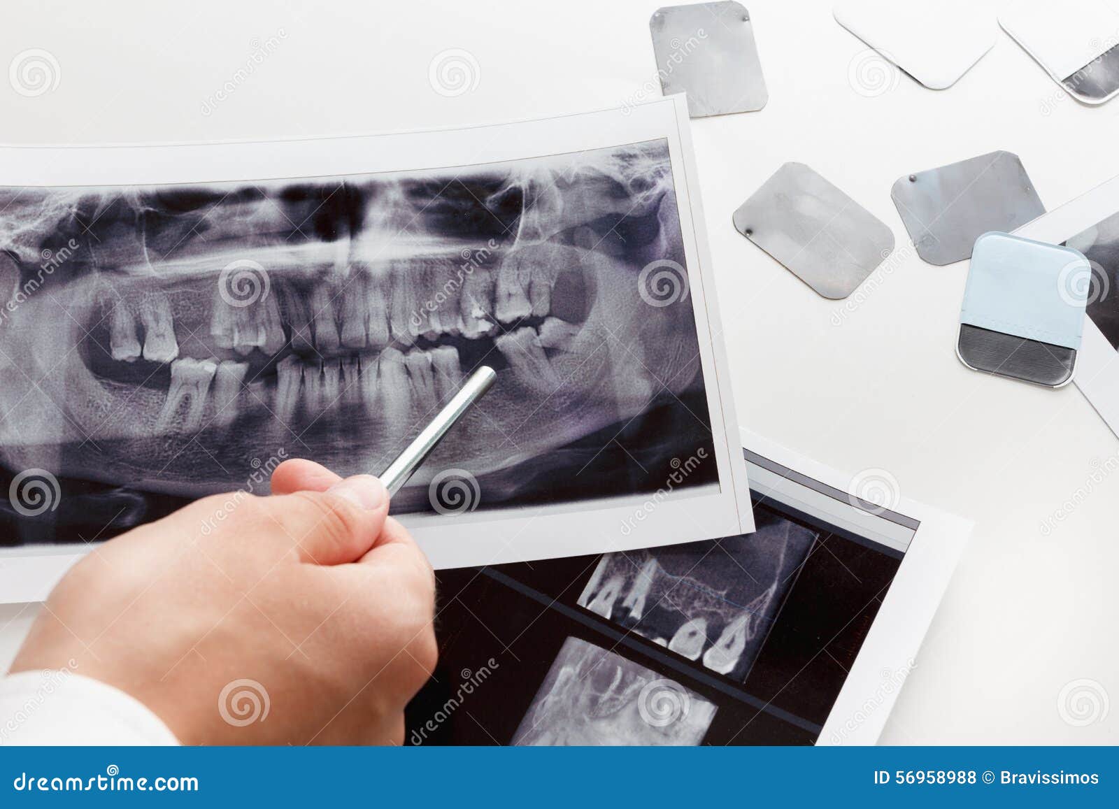 X-ray scan of humans teeth stock photo. Image of care - 56958988